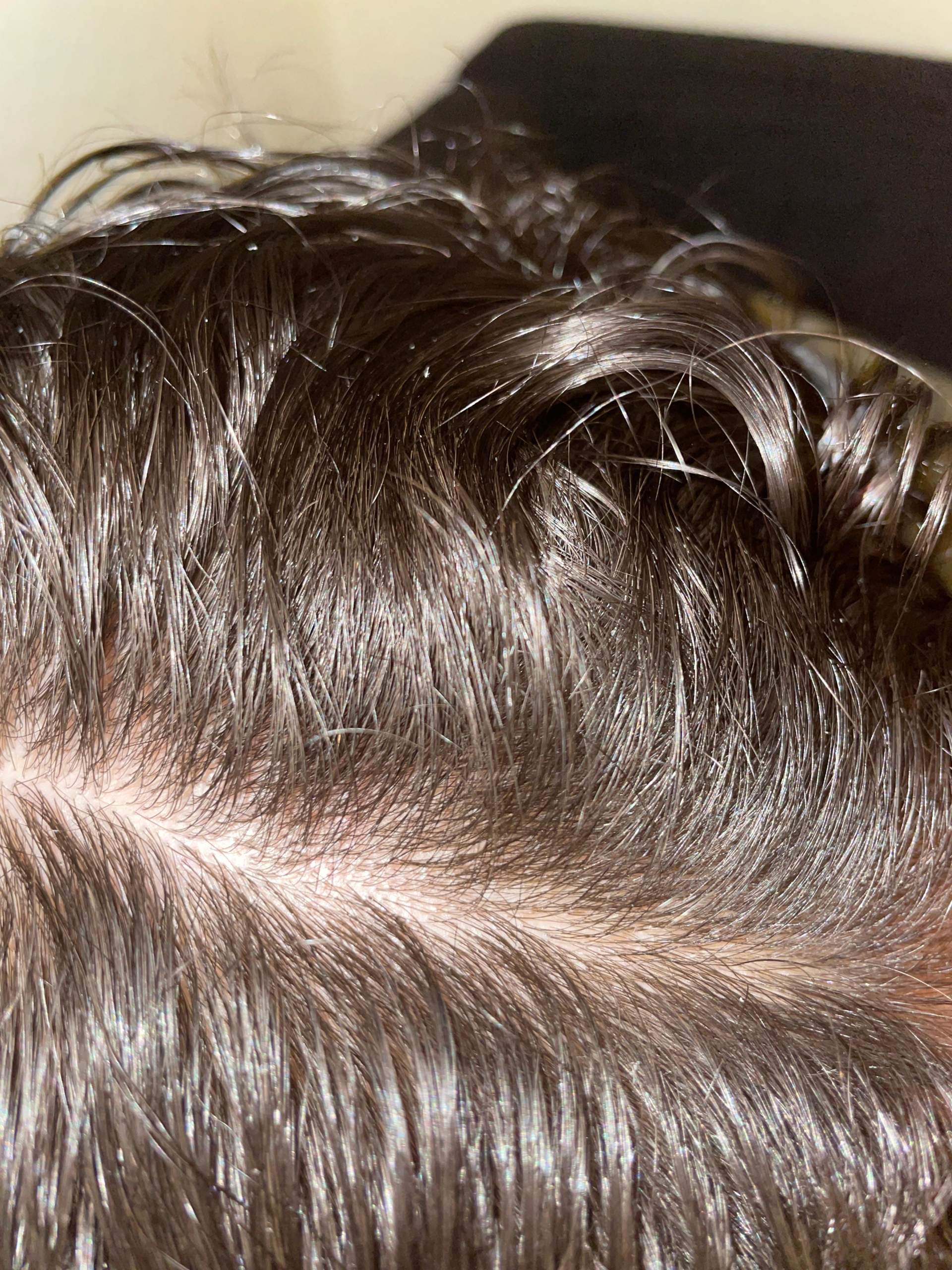 Sind das läuse? (Gesundheit, Haare)