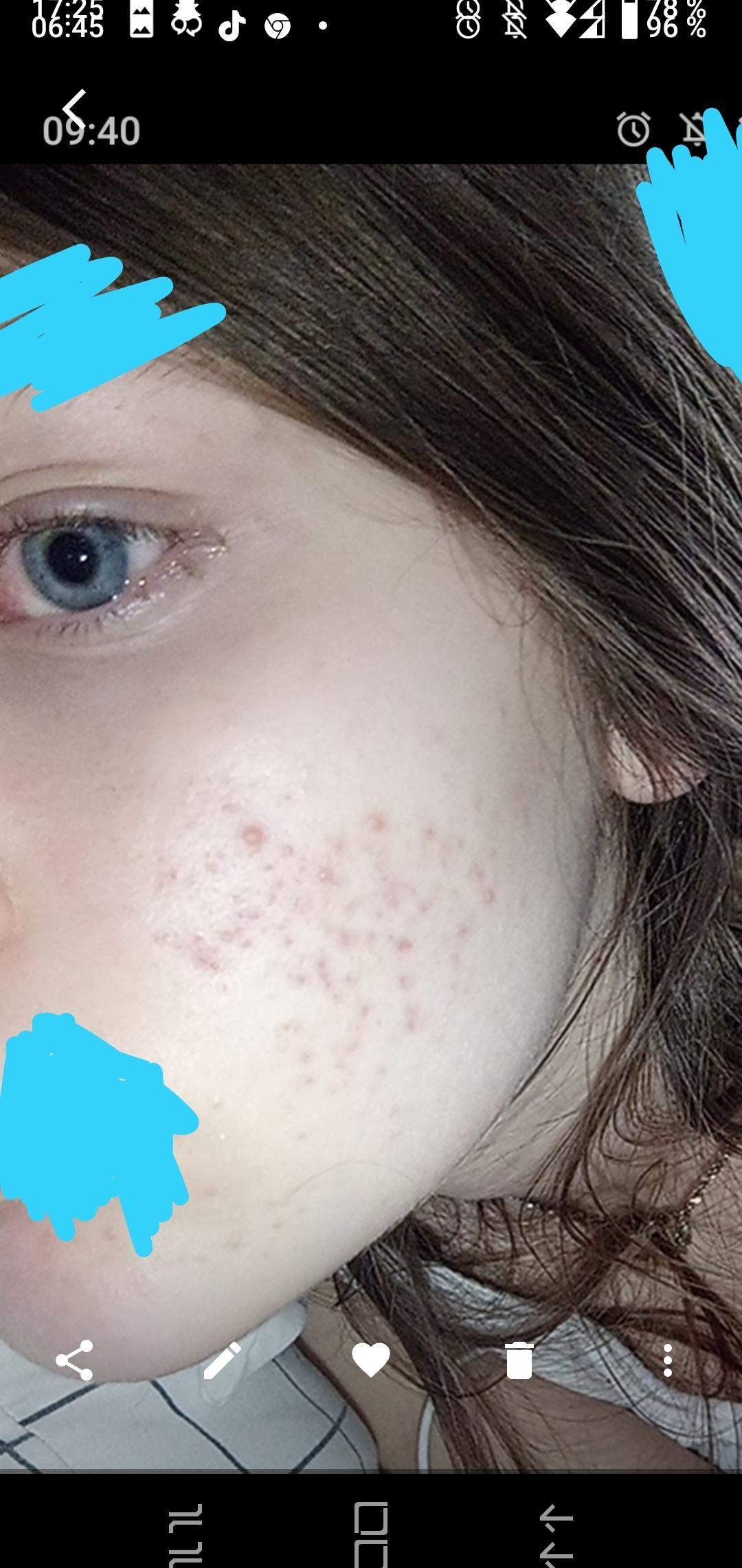 Sind das Pickelmale/Akne Narben oder doch was andres? (Pickel ...