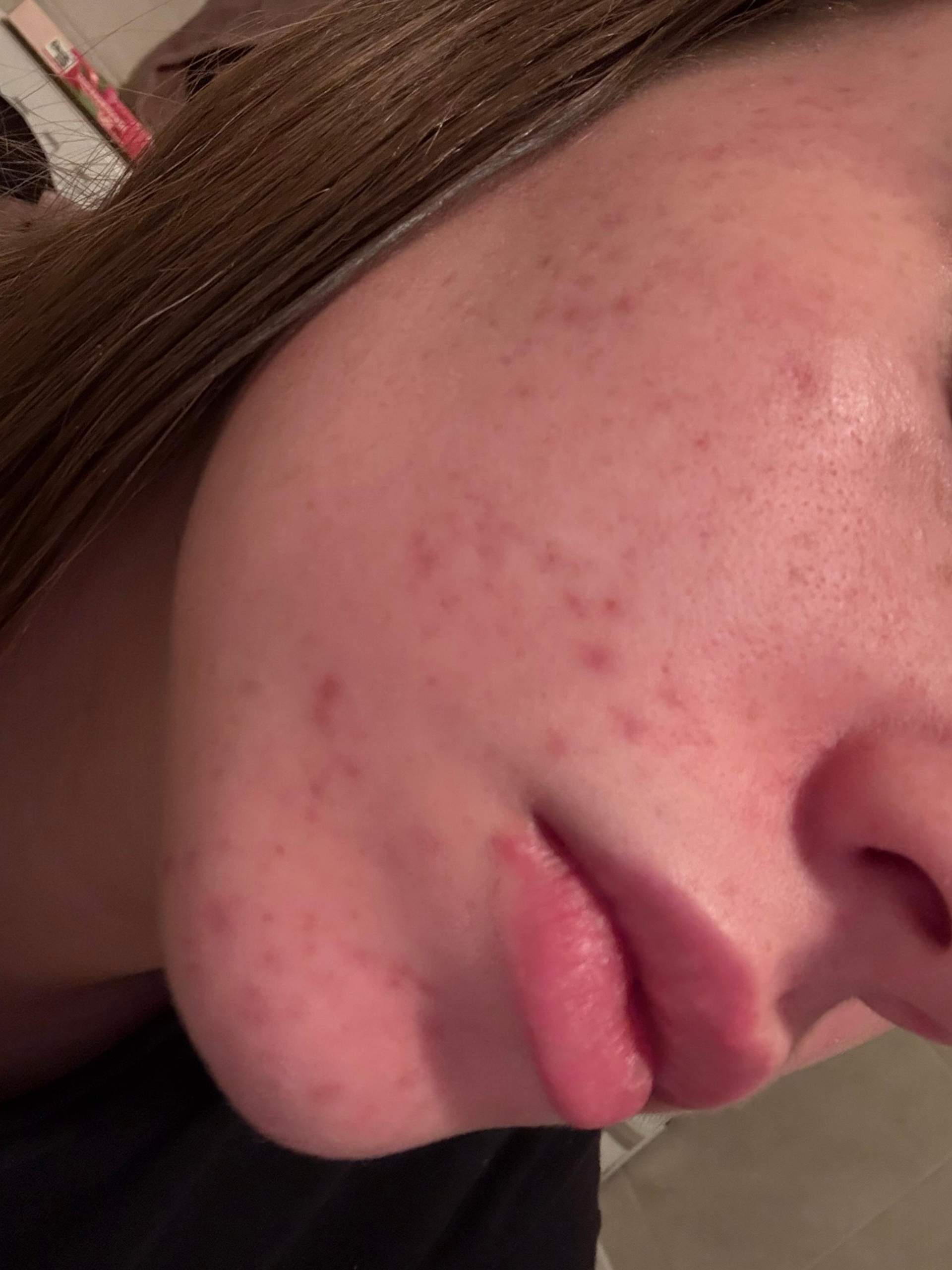 Sind das schon Pickelnarben oder was anderes? (Gesicht, Hautprobleme ...