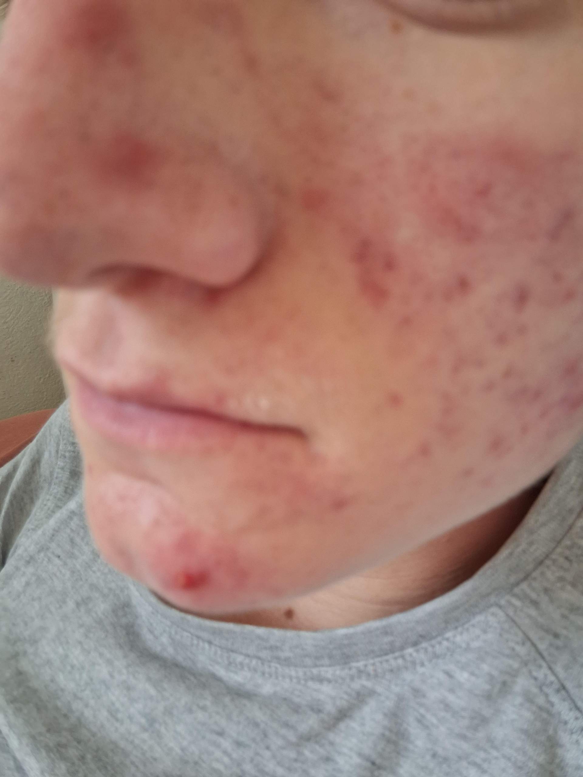 Sind Pikel hormonel oder vererbt? Bzw was hilft am schnellsten gegen ...