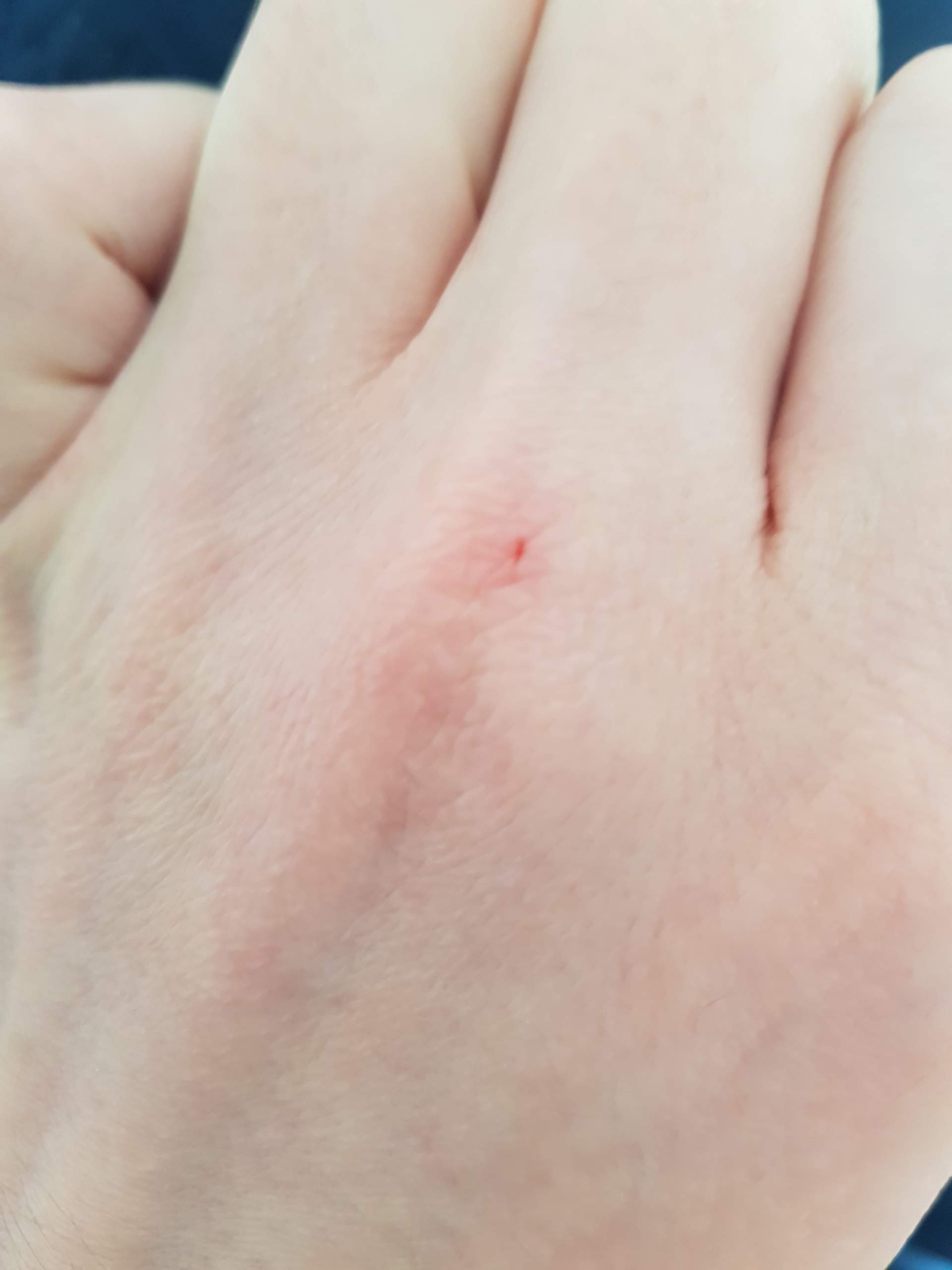 Sollte ich nach einem "Katzenbiss" wirklich zum Arzt? (Gesundheit und ...