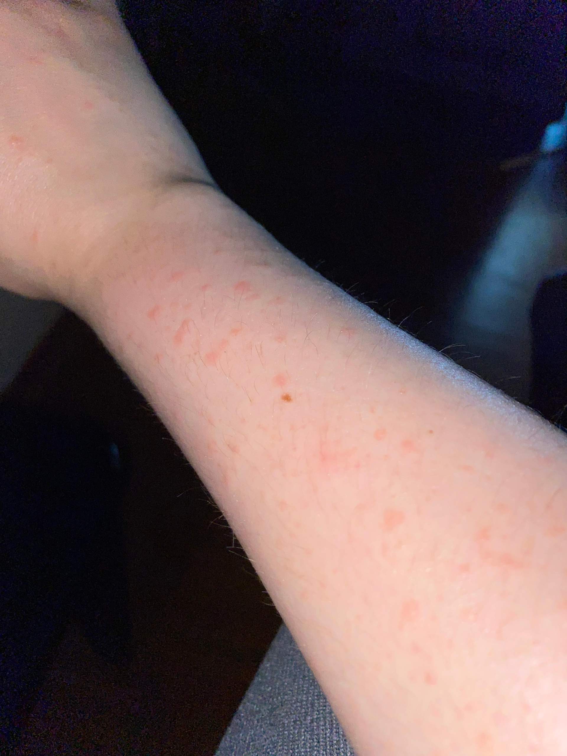 Sonnenallergie? (Gesundheit und Medizin, Haut, Sonne)