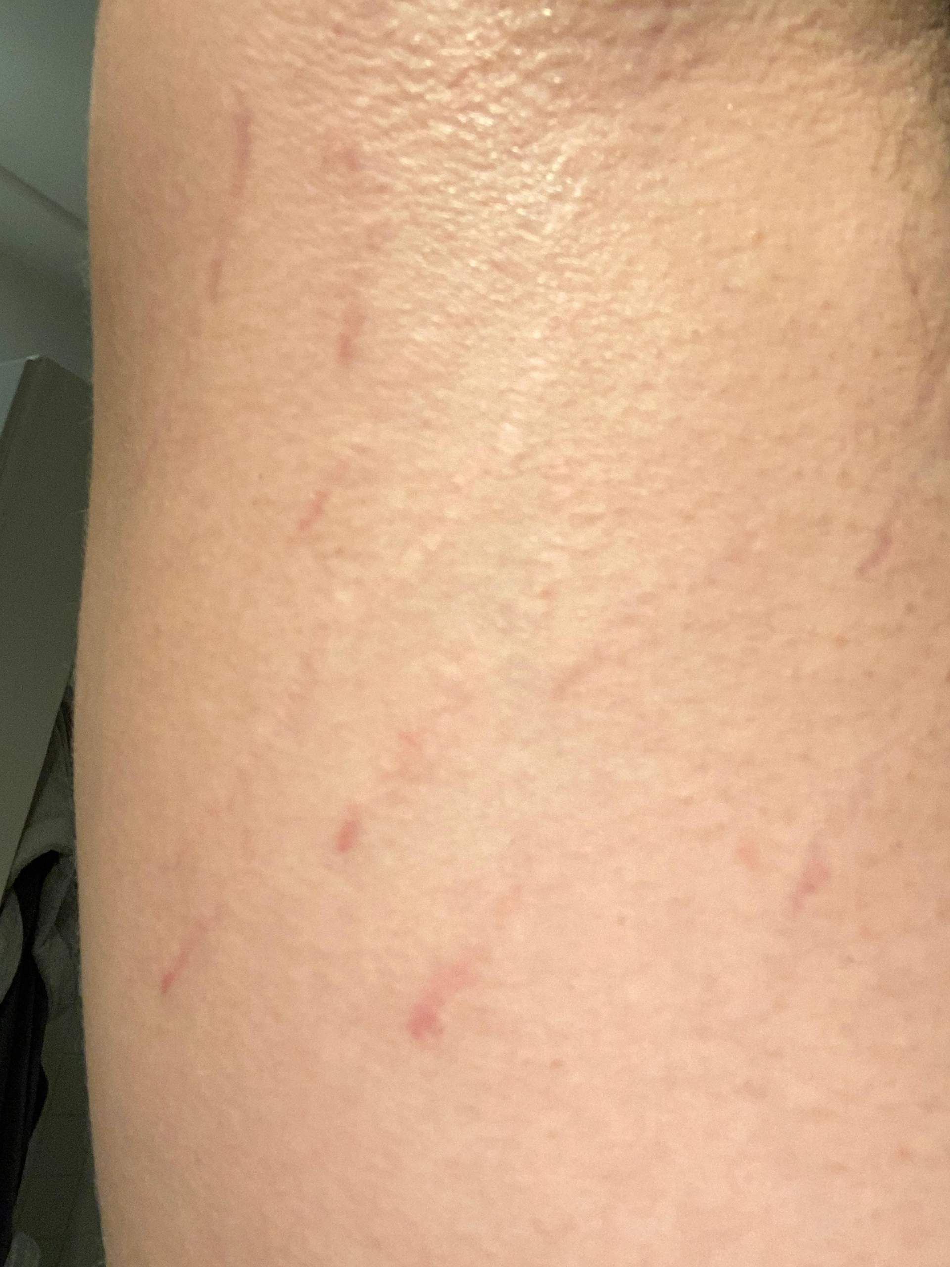 Starke Hautrisse mit 19? (Computer, Gesundheit, Haut)