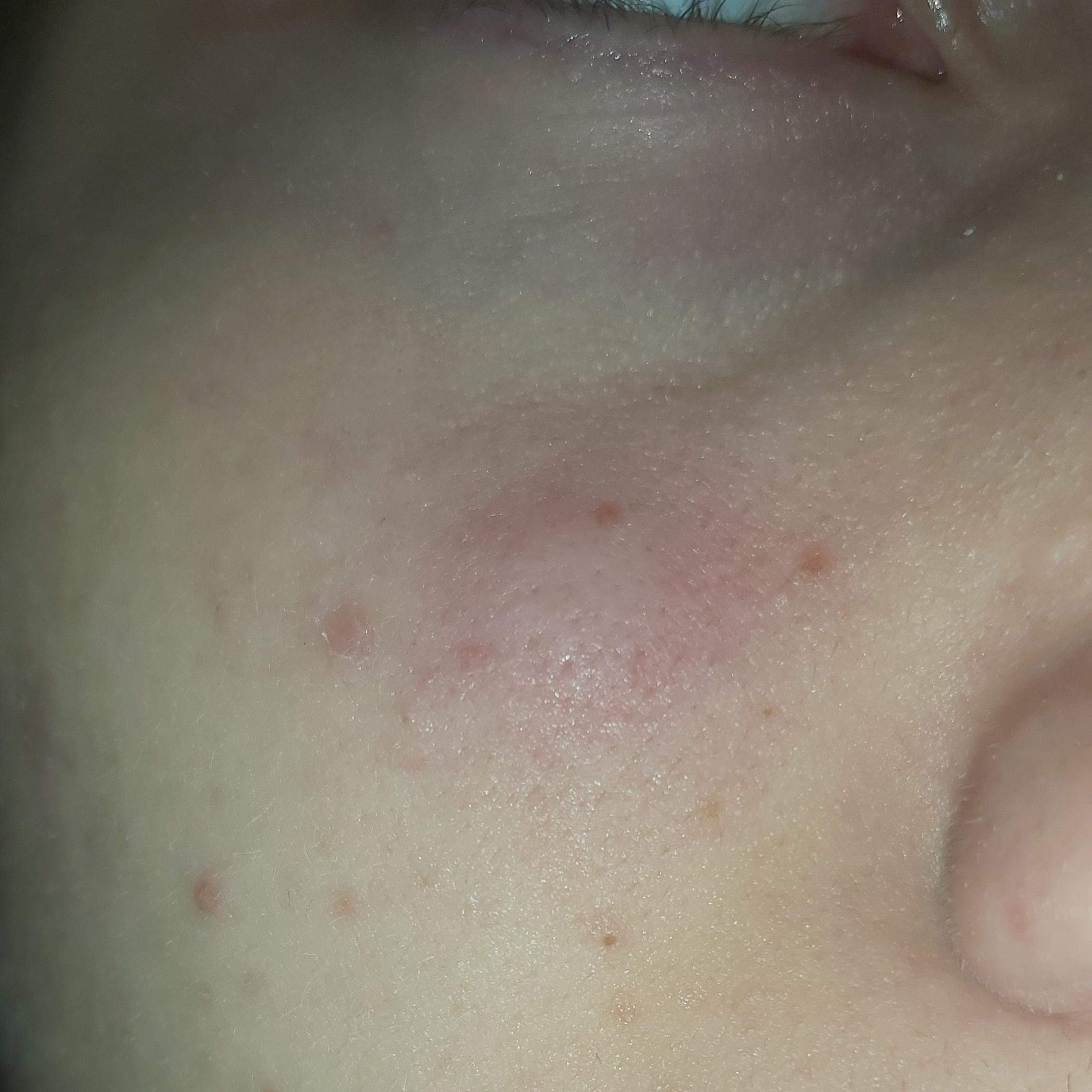 Stellen am Gesicht und auf der Brust? (Medizin, Haut, Pickel)