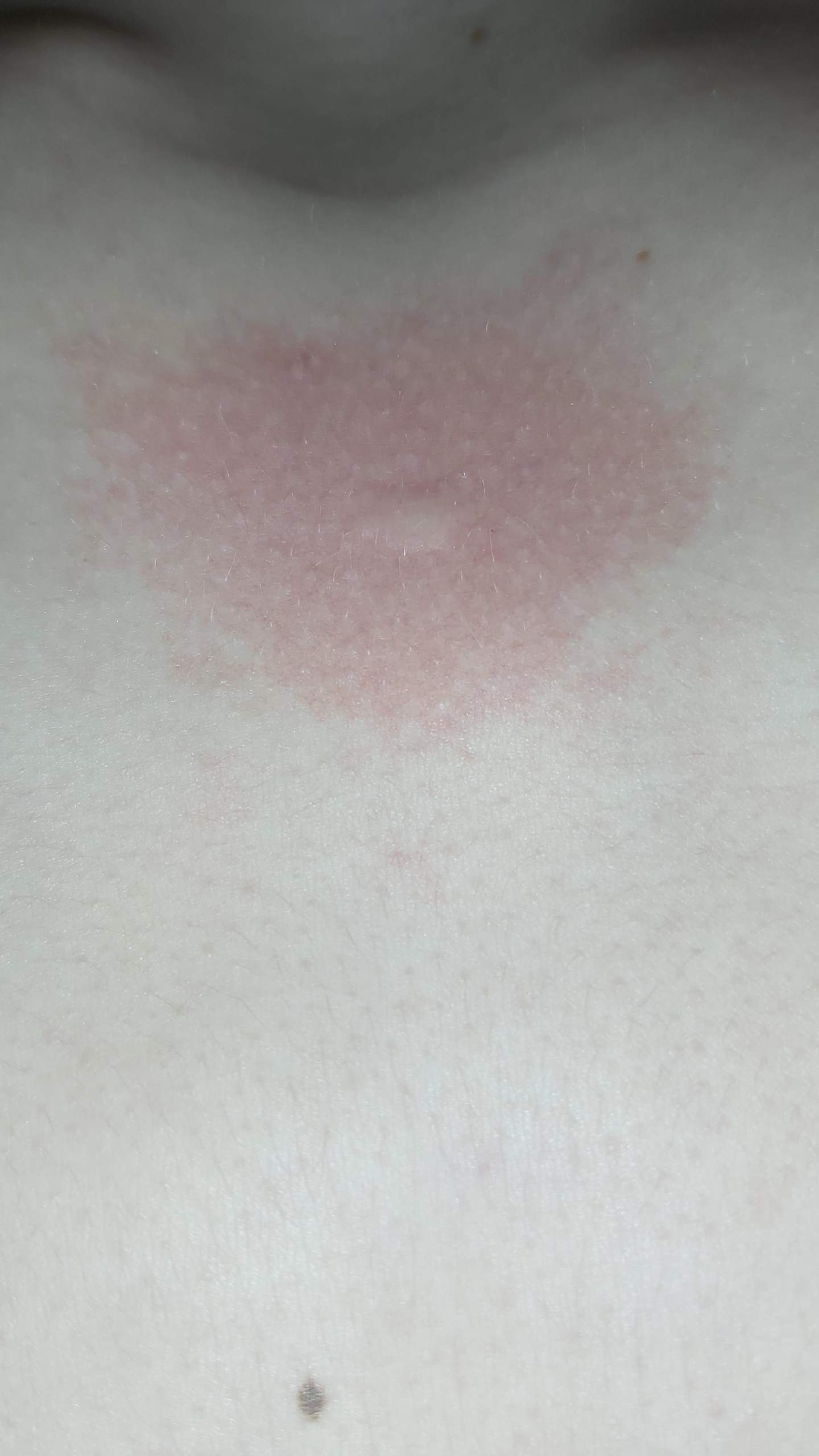 Stellen am Gesicht und auf der Brust? (Medizin, Haut, Pickel)