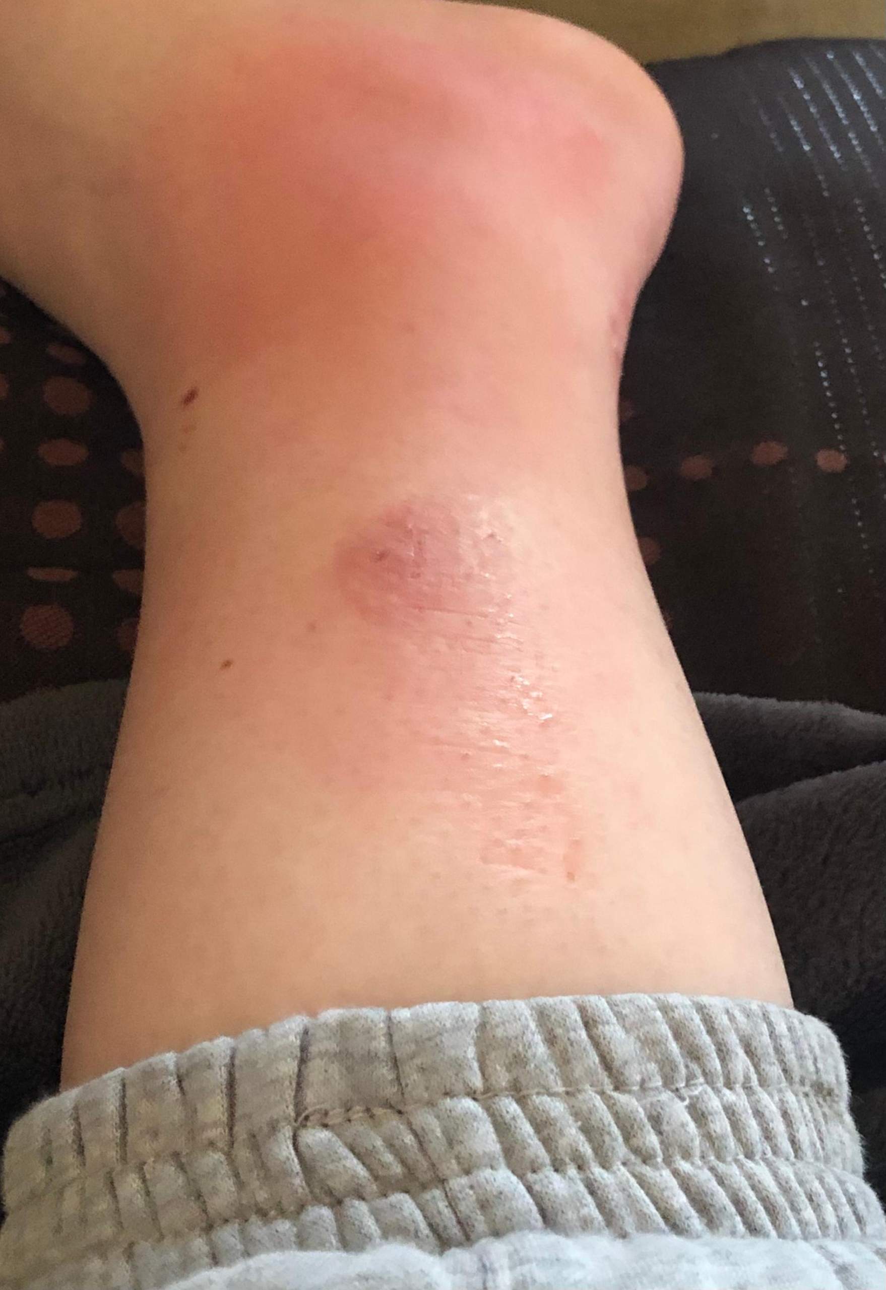 Stich ist sehr stark angeschwollen? (Gesundheit und Medizin, Insekten ...