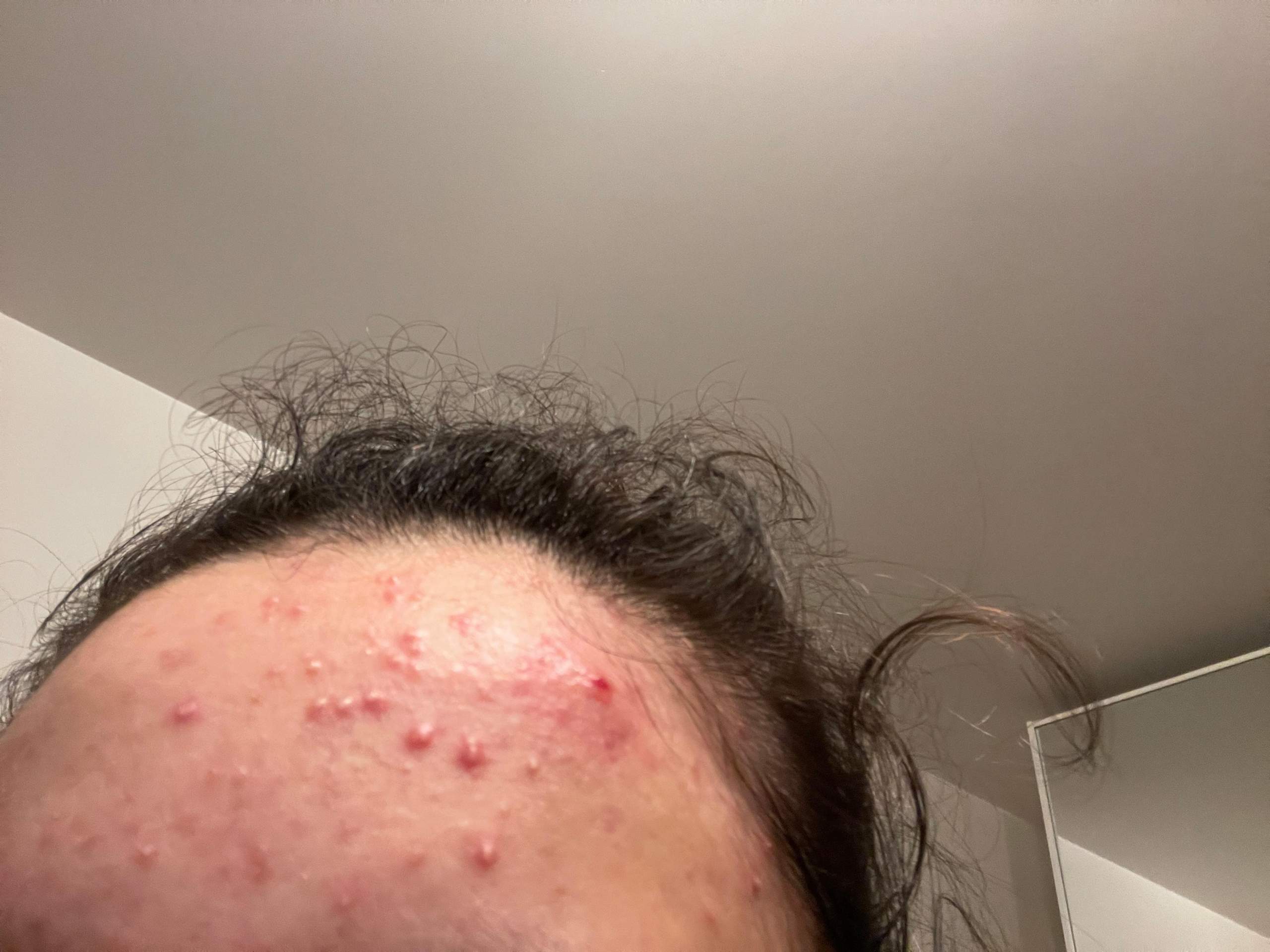 Stirn Akne Hilfe? (Haut)