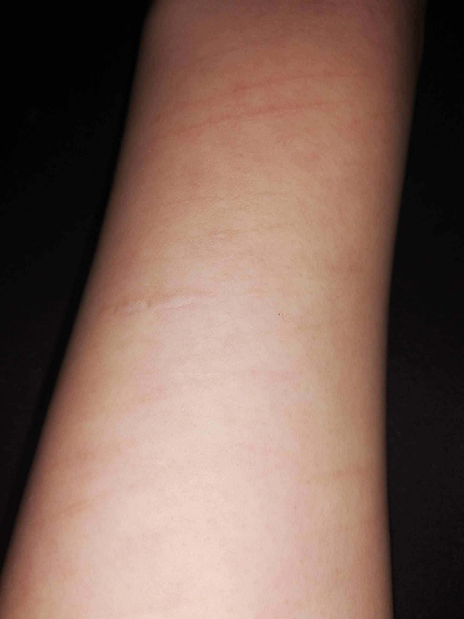 Tattoo über Narben vom ritzen? (Haut, tätowieren, Tätowierer)