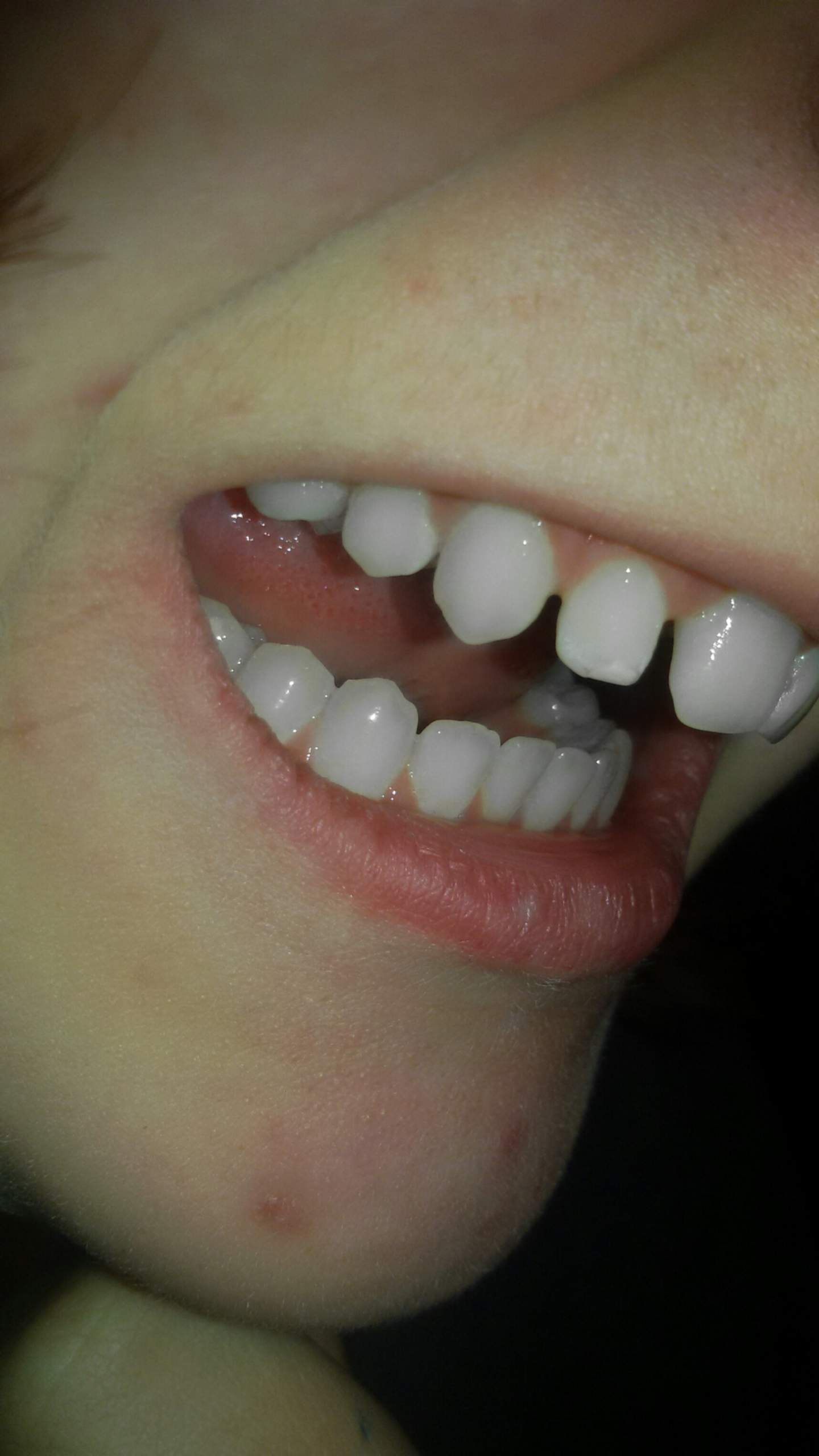 Tiefbiss, Deckbiss, Übergebiss, Kreuzbiss, Lückengebiss oder normal ...