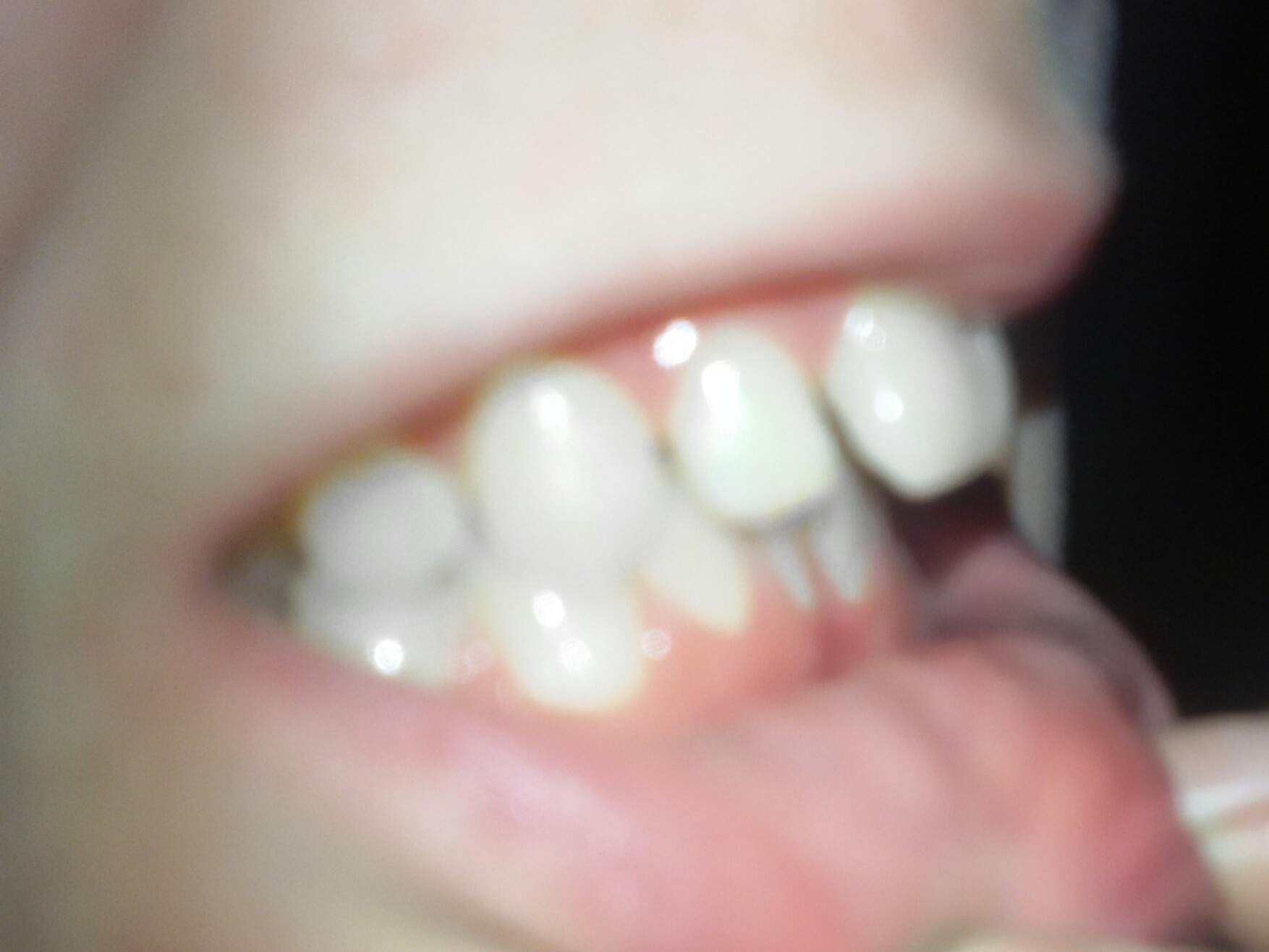 Tiefbiss, Deckbiss, Übergebiss, Kreuzbiss, Lückengebiss oder normal ...