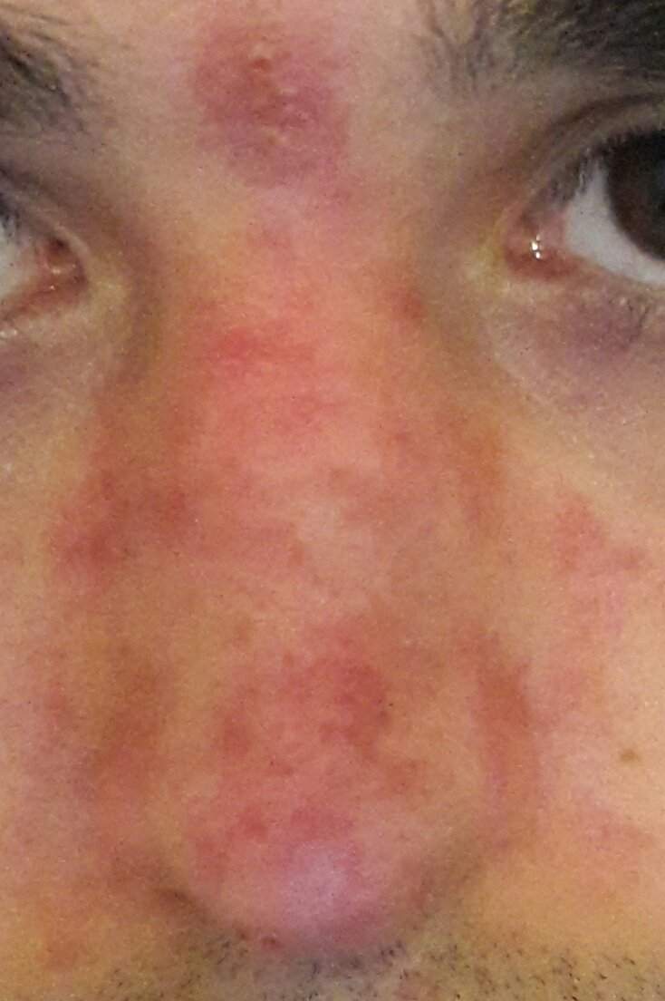 Tipps gegen starke Rötungen auf der Nase? (Medizin, Chemie, Haut)