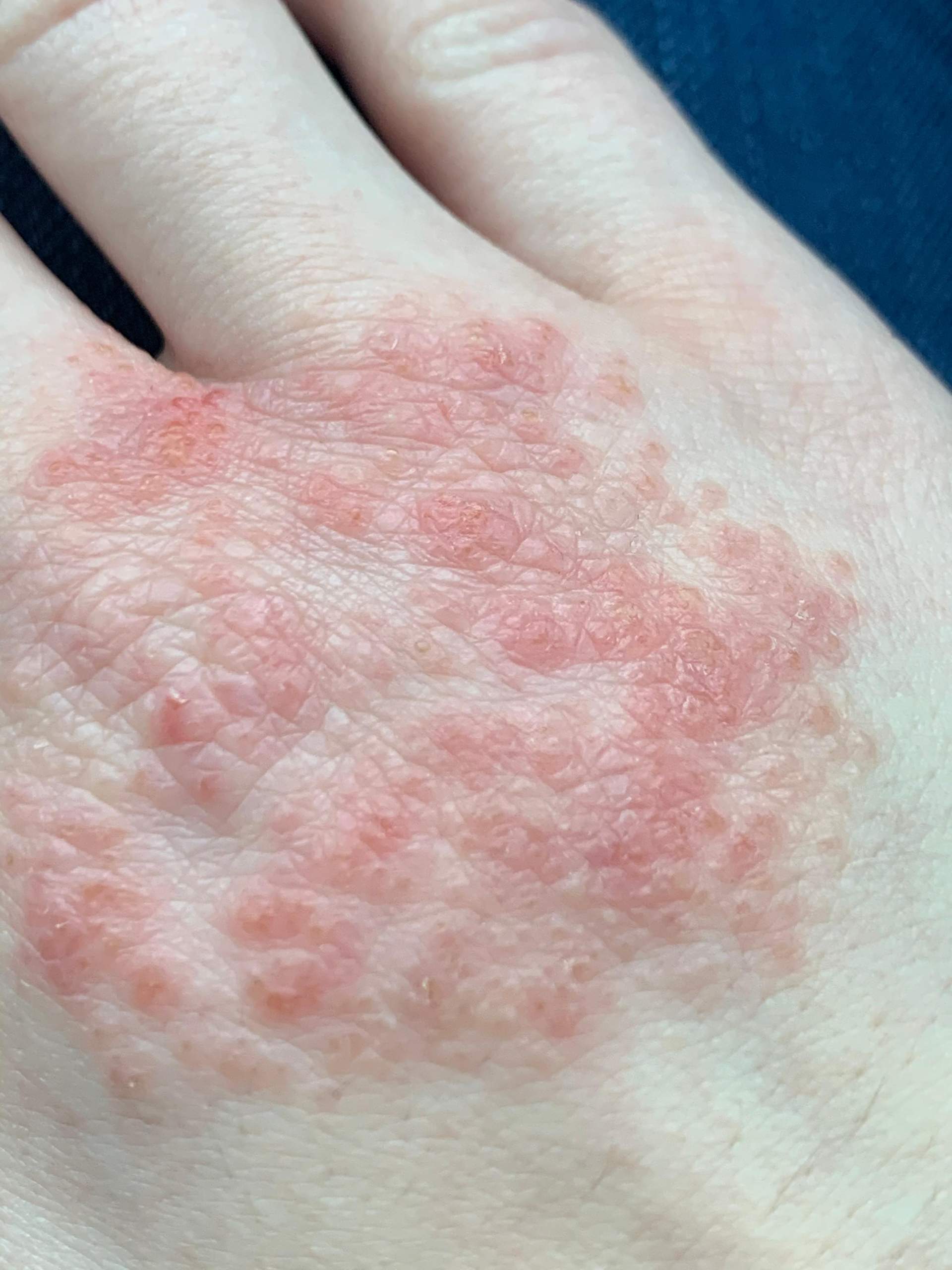 Tipps zu Neurodermitis/Handekzem? (Gesundheit und Medizin, Hautpflege)