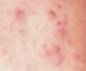 Über nacht ganz viele Pickel am Po, was machen? (Akne, after, Popo)