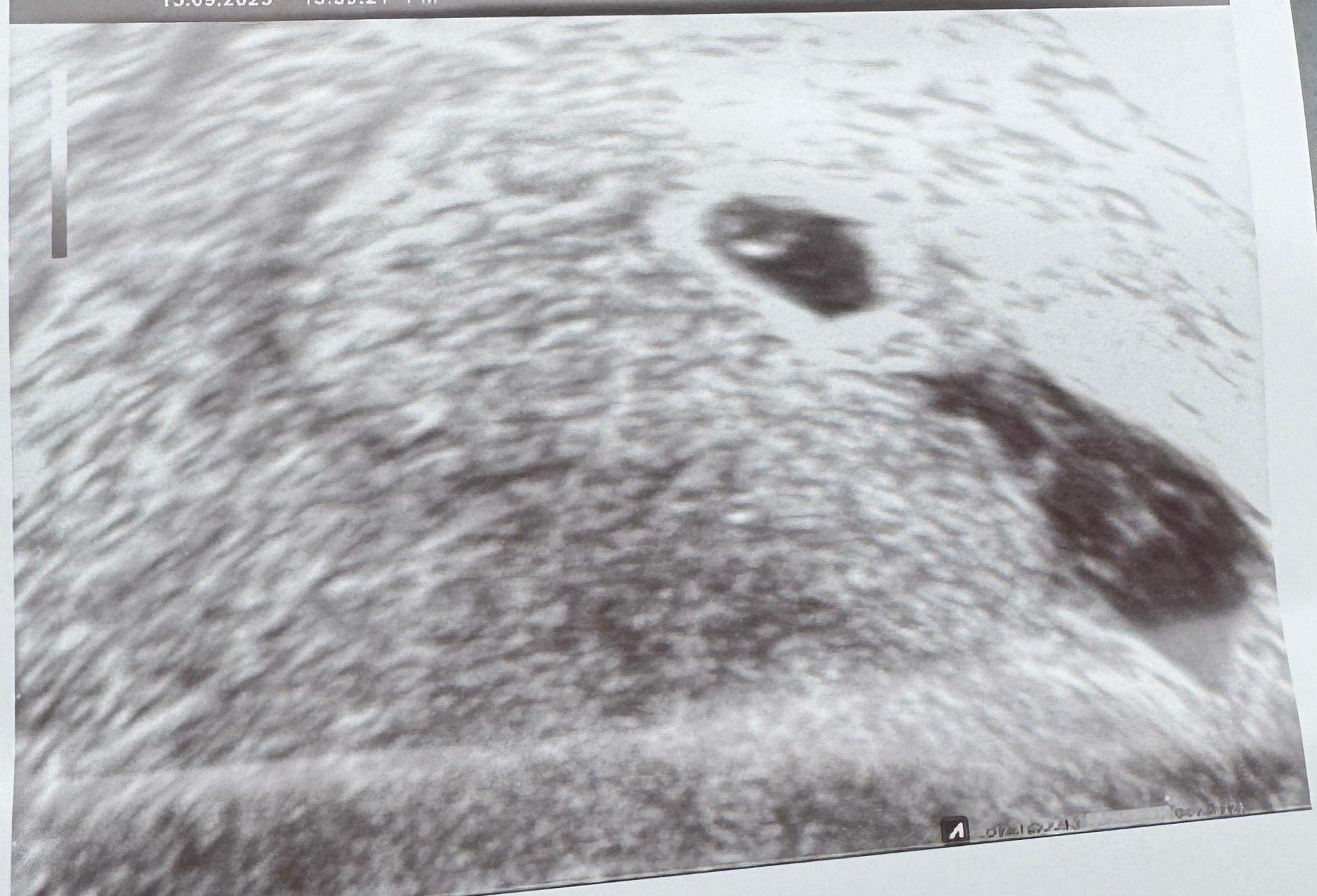 Ultraschall 5+4? (Gynäkologe, Zwillinge, Fehlgeburt)