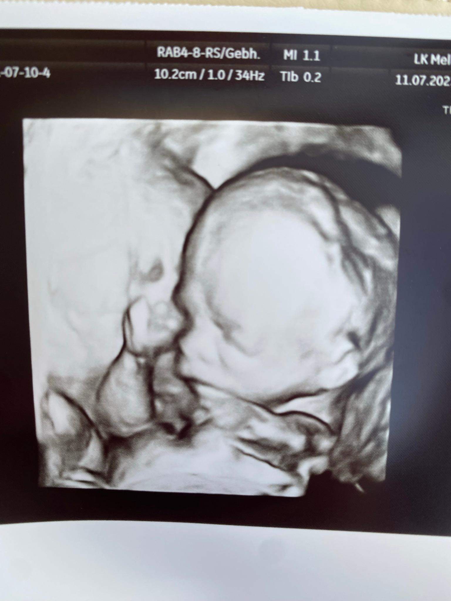 Ultraschallbild normal? (Gesundheit und Medizin, Baby, Gynäkologie)