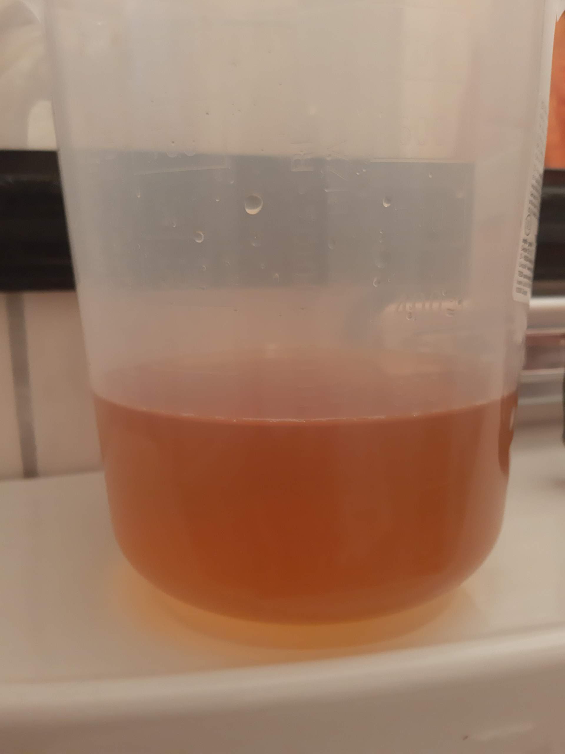 Urologischer Fall ist der Urin rötlich trüb? (Urologie)