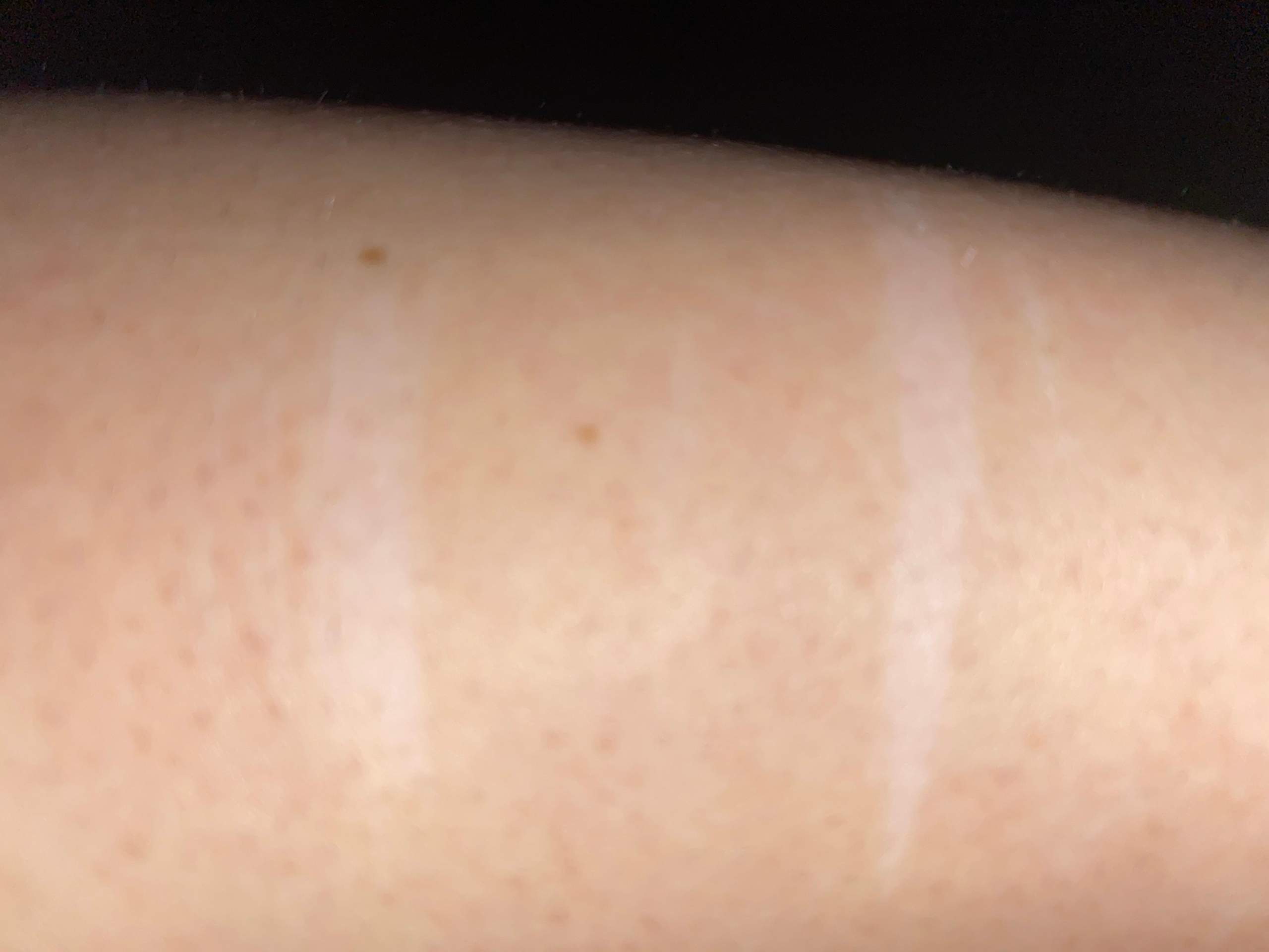 Verblasst diese Narbe noch? (Gesundheit und Medizin, Narben)