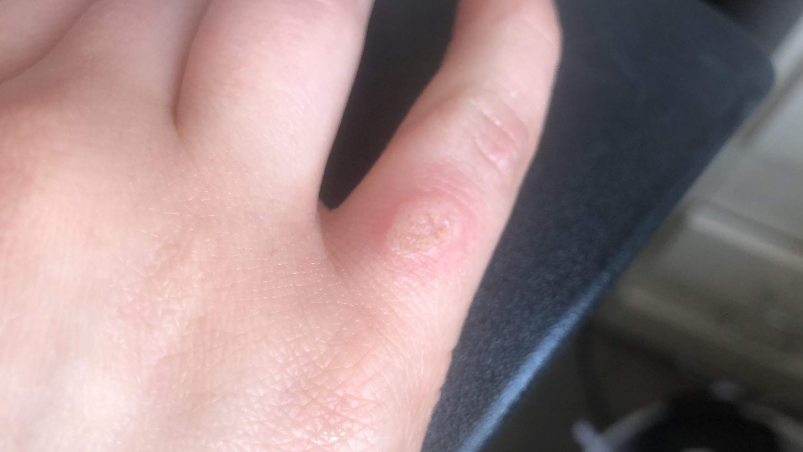 Verbrannt kleine Finger, schlimm? (Verbrennung)