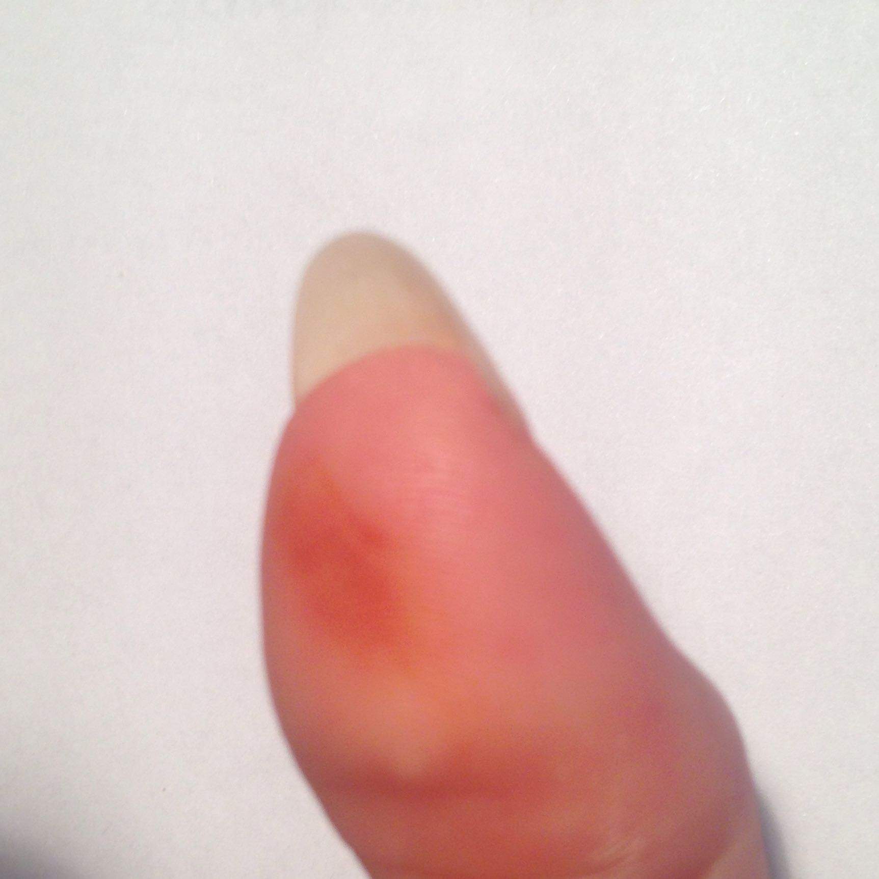 Verbrennung an der Fingerspitze!? (braun)