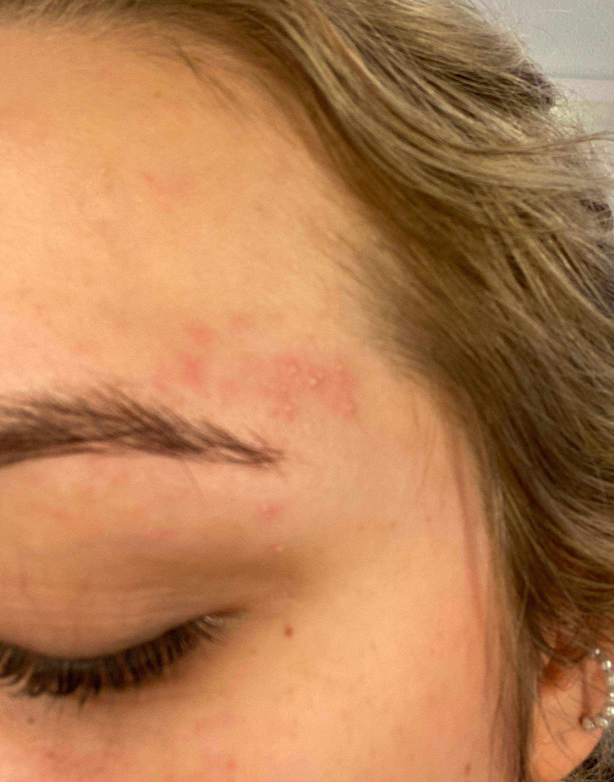 Viele kleine eitrige Pickel, was kann ich tun? (Haut)