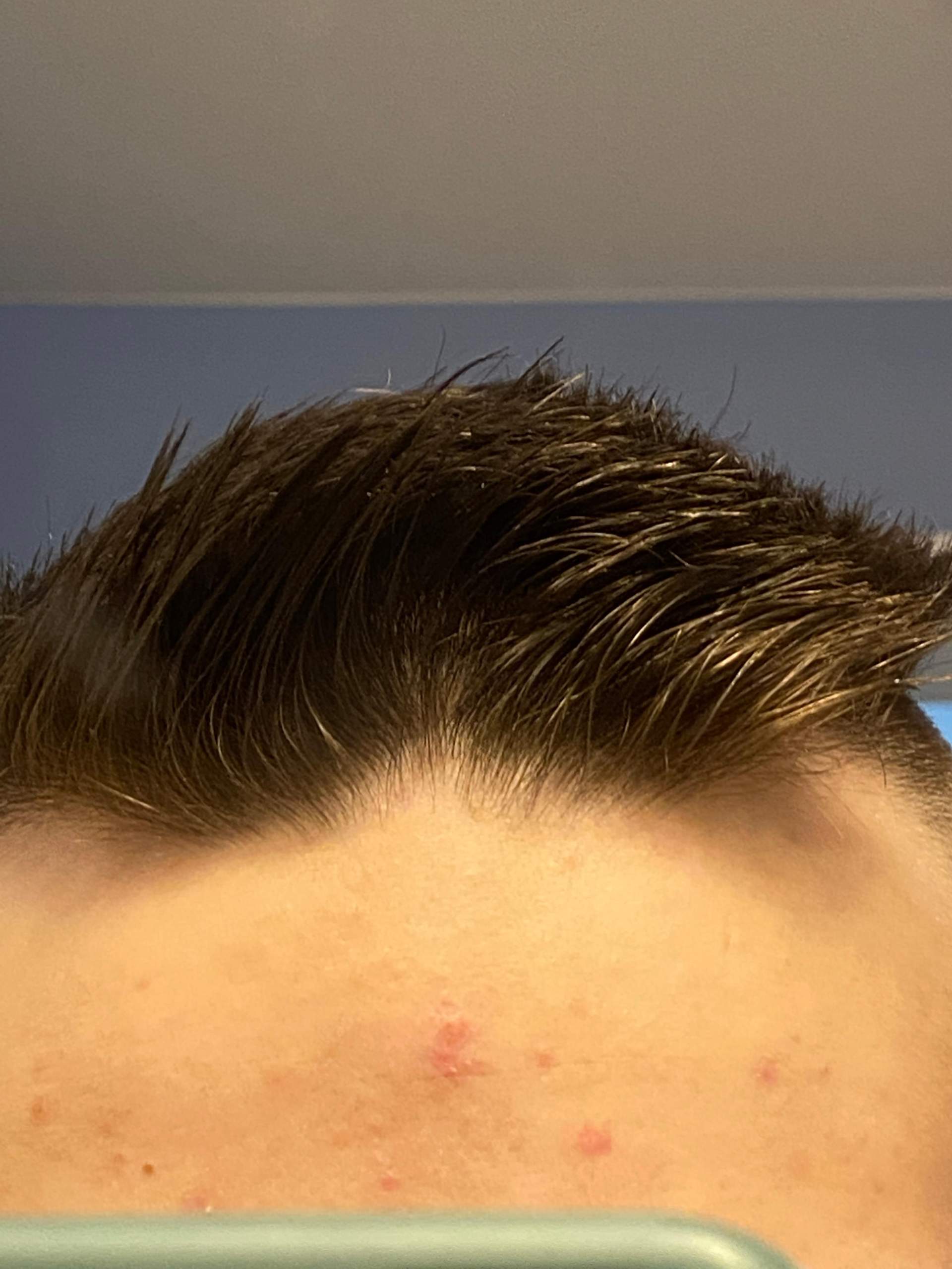 Metformin Haare Wachsen Wieder