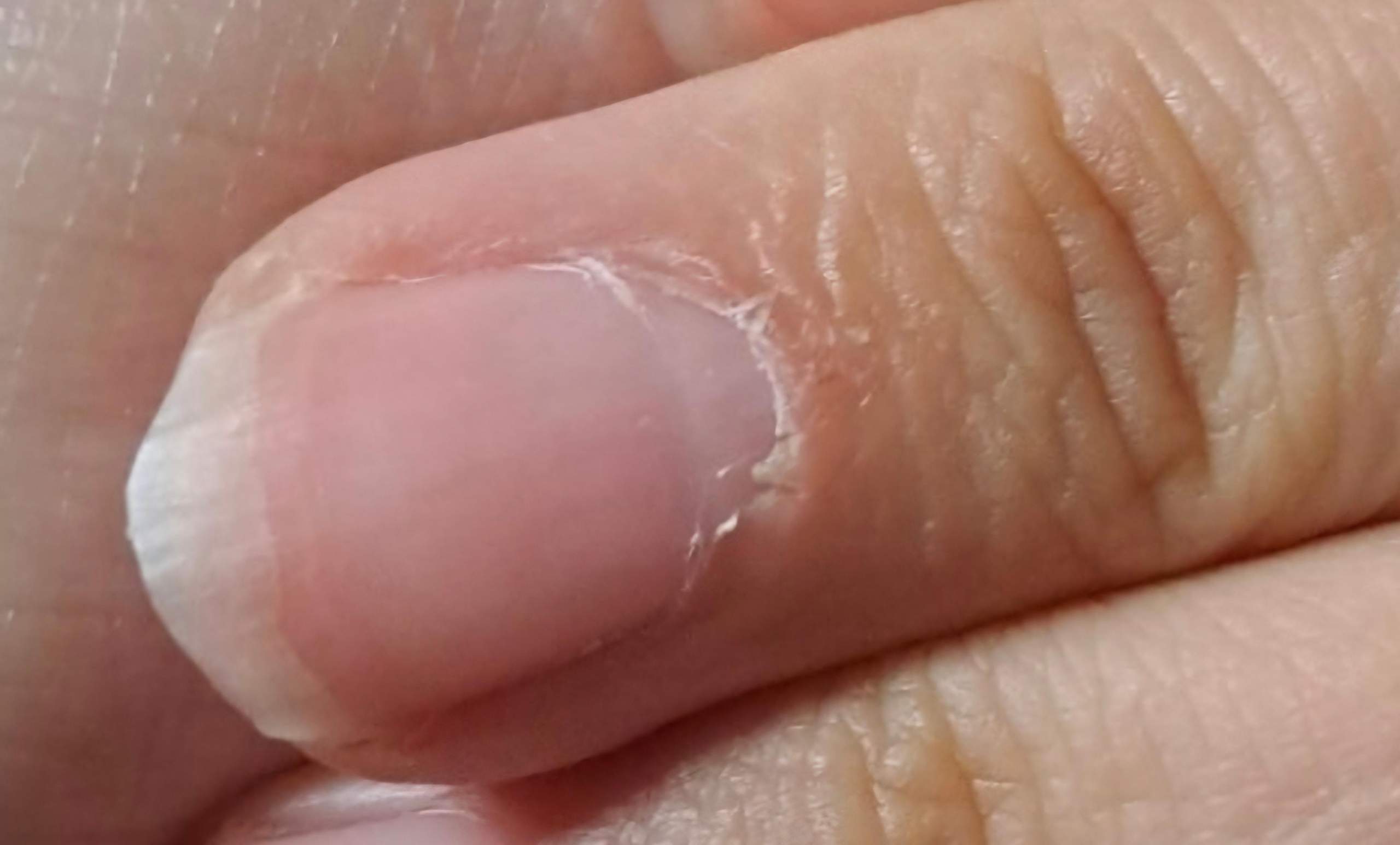 Warum geht die Haut zurück und wächst das wieder vor.? (Nägel, nagelbett)