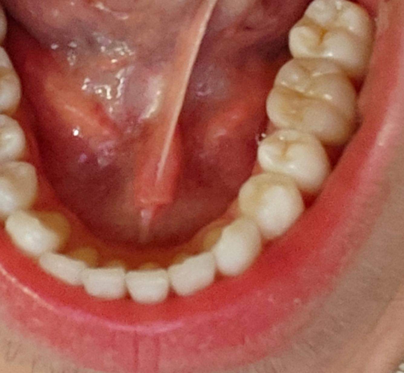 Warum habe ich mit 19 diese Zahnprobleme? (Zähne, Zahnarzt, Zahnmedizin)