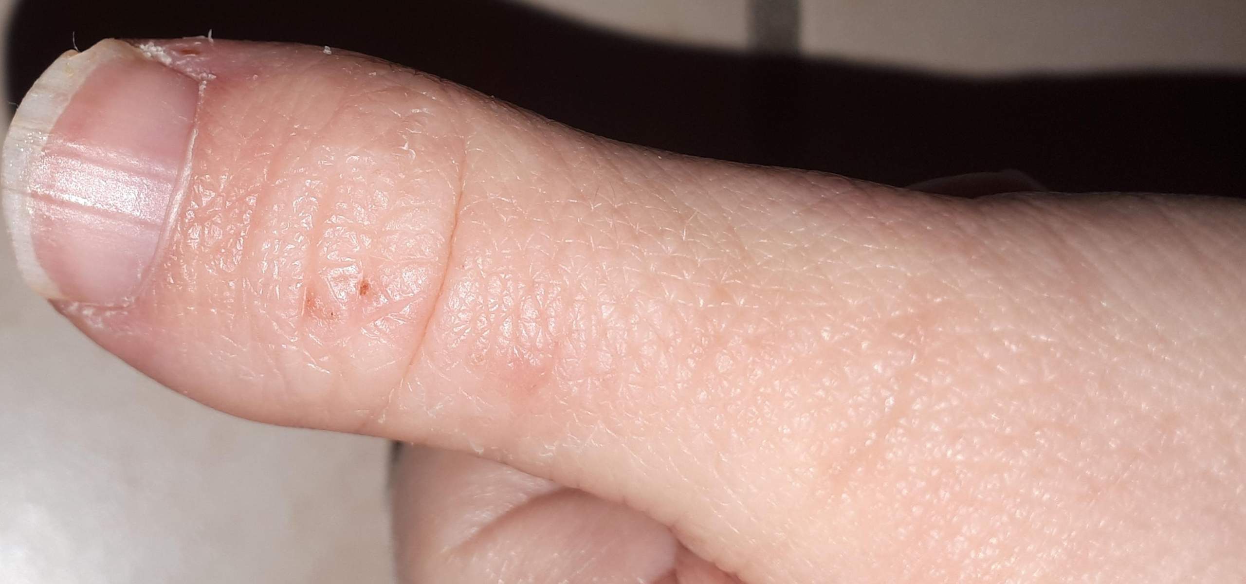 Warum ist der eine daumen kleiner und dicker als der andere ...