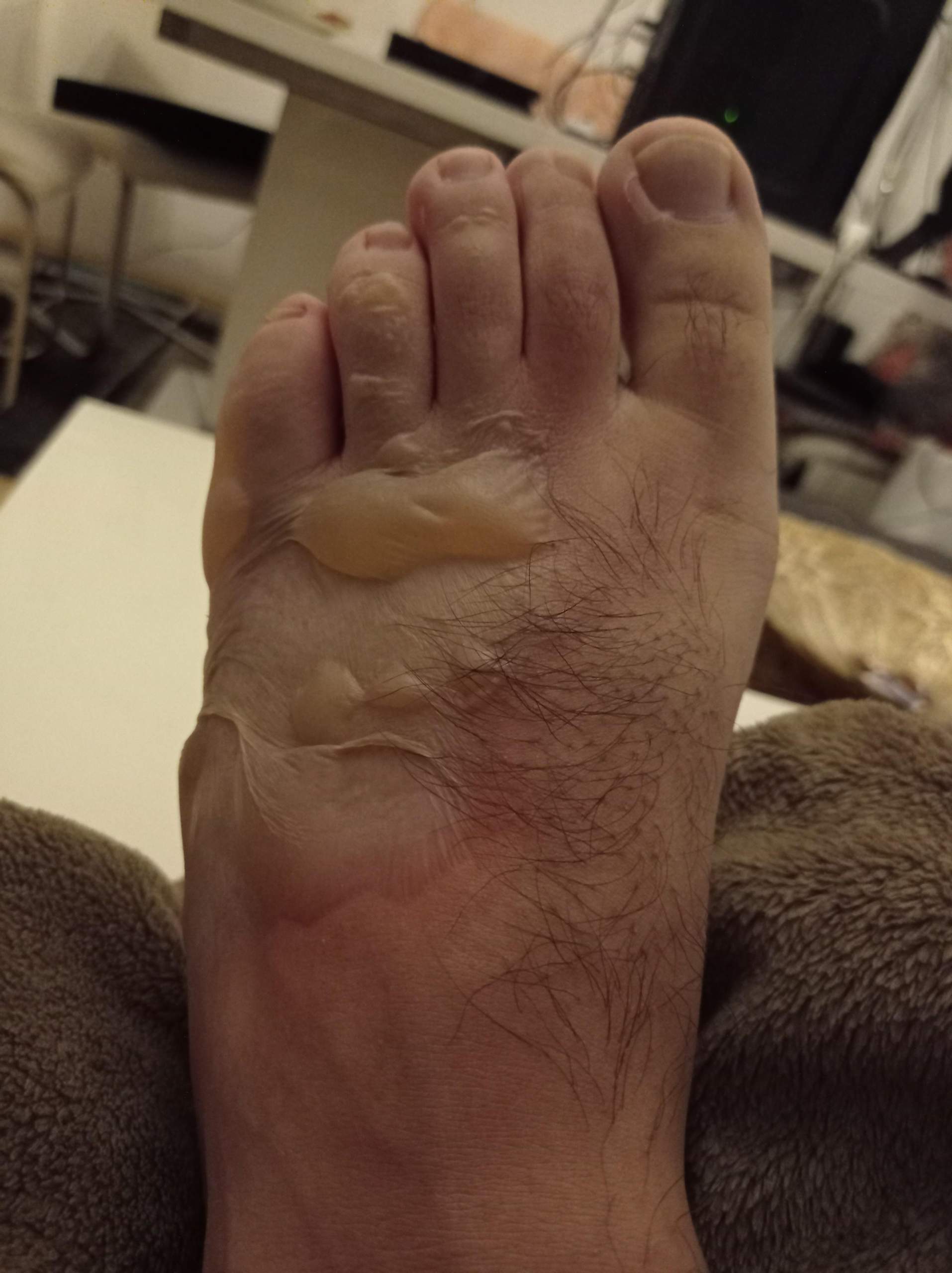 Warum sind meine Brandblasen so schlimm geworden? Wie soll ich sie ...