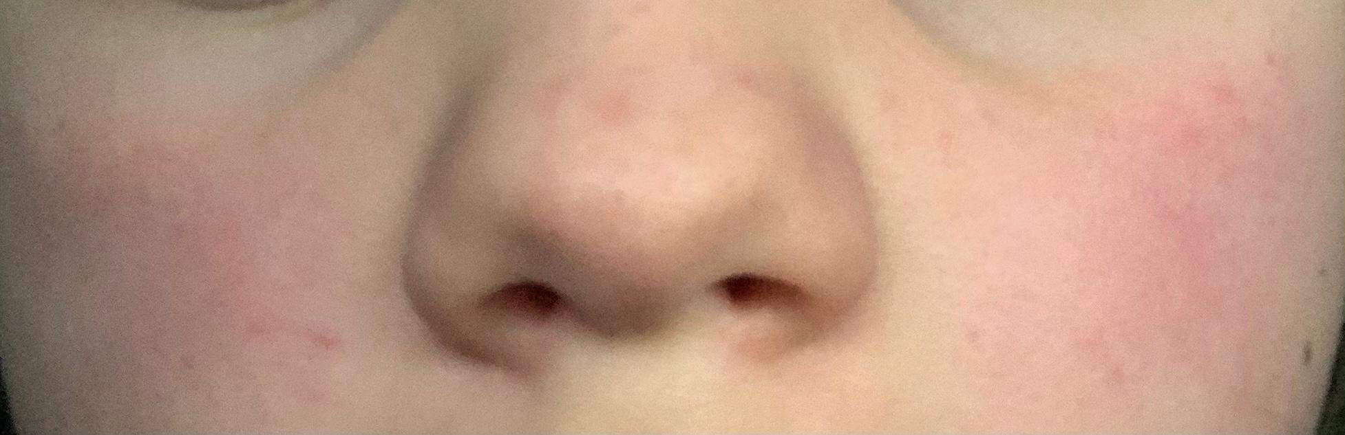 Was bedeuten rote Punkte auf der Wange und Nase? (Gesundheit und ...