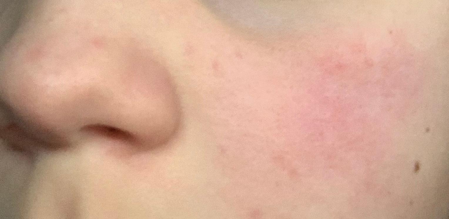 Was bedeuten rote Punkte auf der Wange und Nase? (Gesundheit und ...