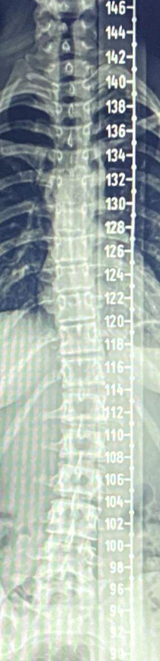 Was denkt ich wie viel grad Skoliose ist das? (Rücken, Orthopäde ...
