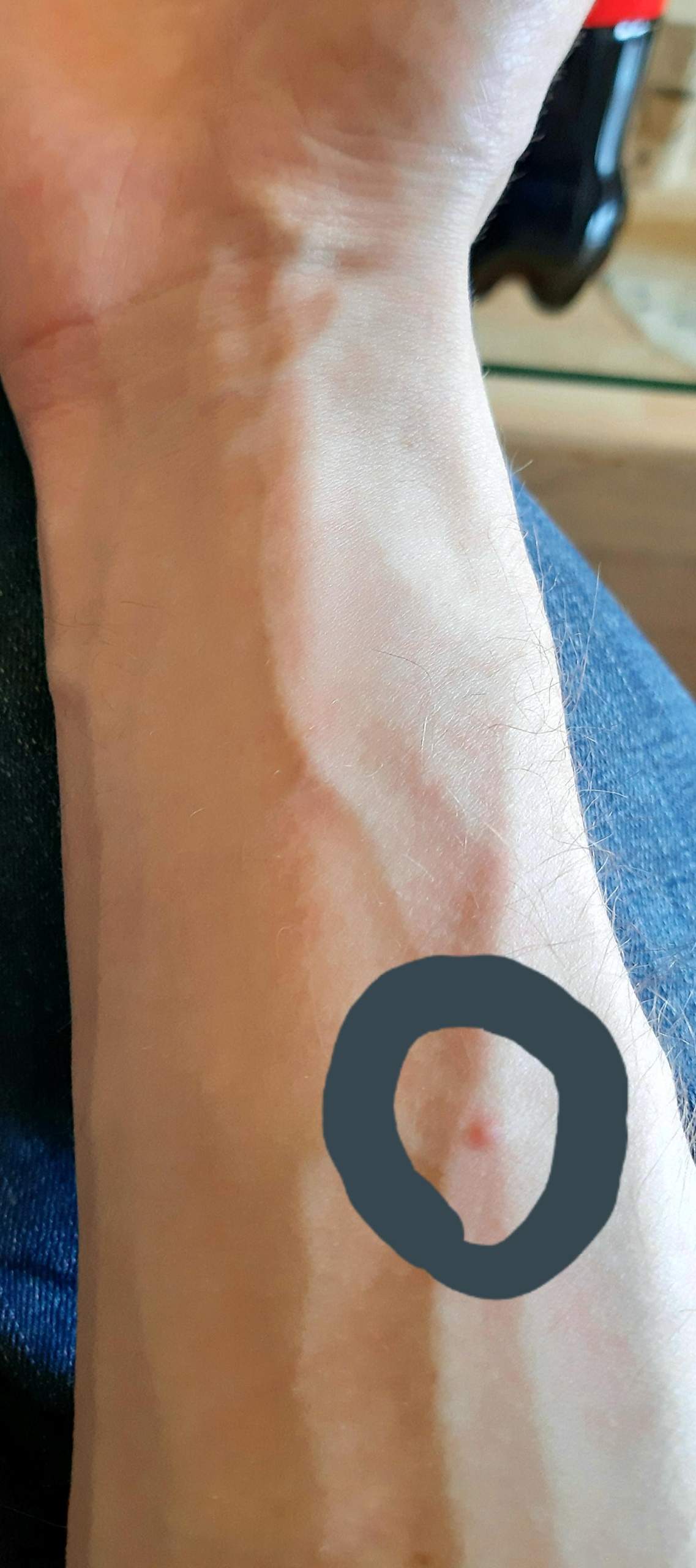 Was habe ich da am Unterarm (Foto) - Stich oder Pickel? (Gesundheit und ... Was habe ich da am Unterarm (Foto) - Stich oder Pickel? (Gesundheit und ...