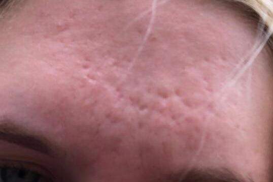 Was hilft gegen akne Narben im Gesicht ? (Gesundheit und Medizin)