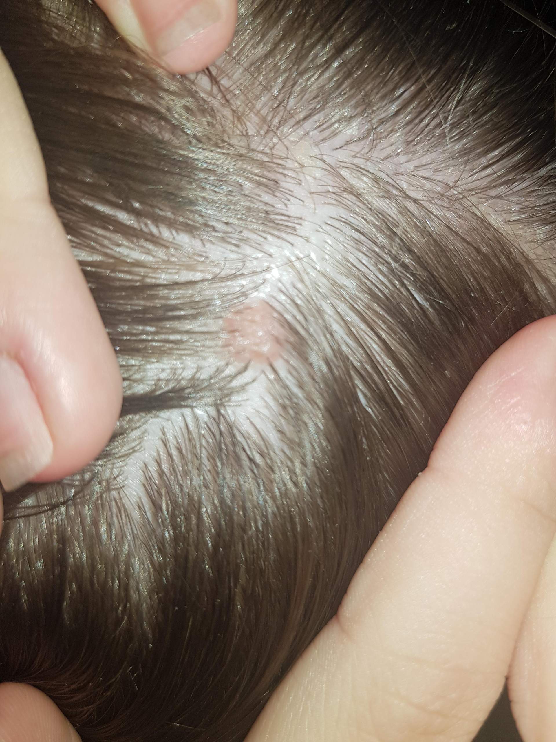 Was ist das? (Muttermal)