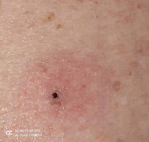 Was ist das? (Haut, Schwarzer Punkt)