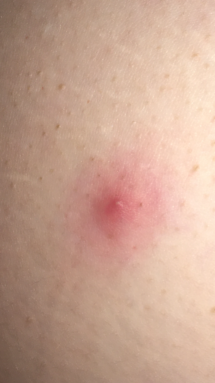 Was ist das bitte an meinem bein bitte um hilfe von euch? (Haut, Pickel ...