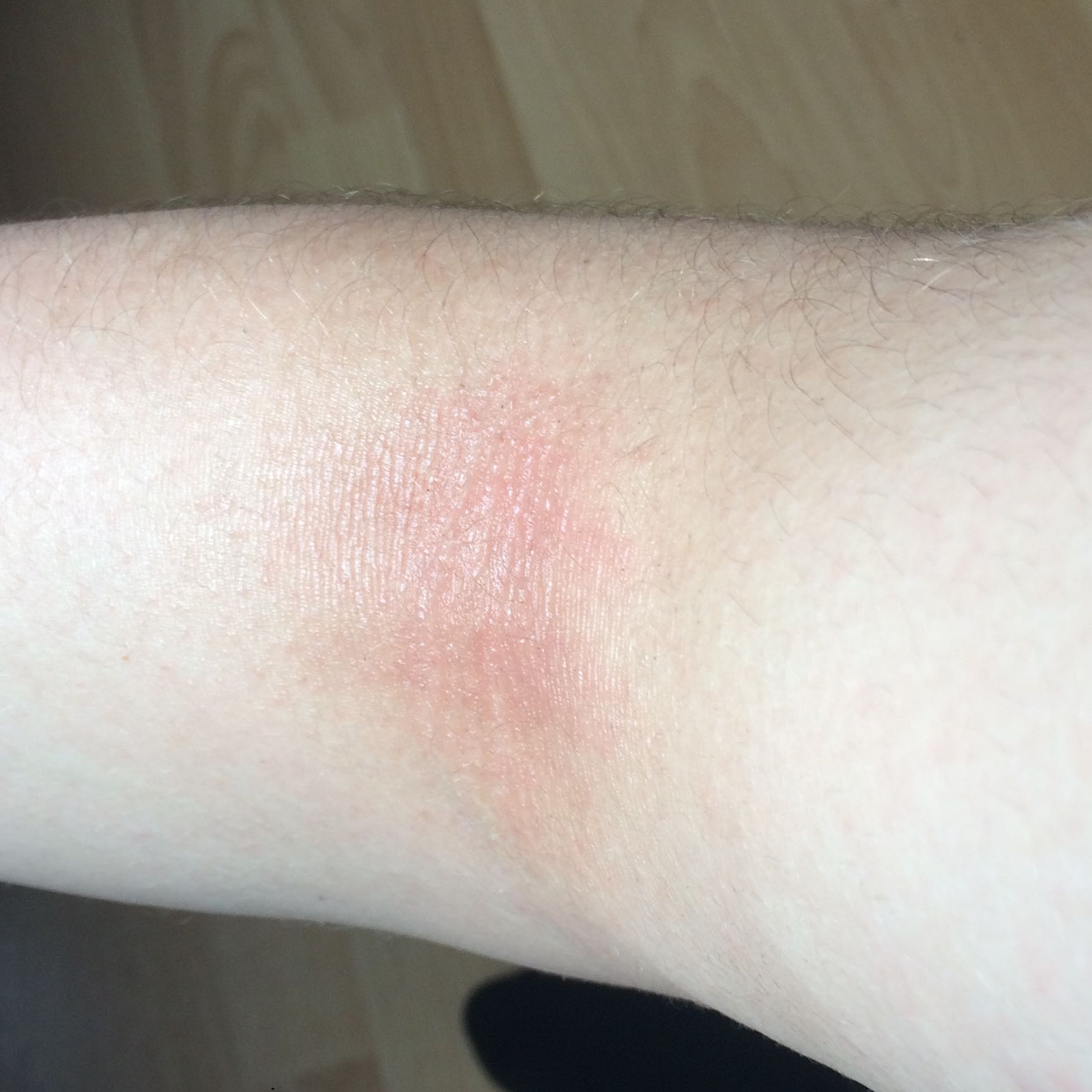 Allergie Im Haut Am Unterarm | Allergie: Symptome, Ursachen und ...