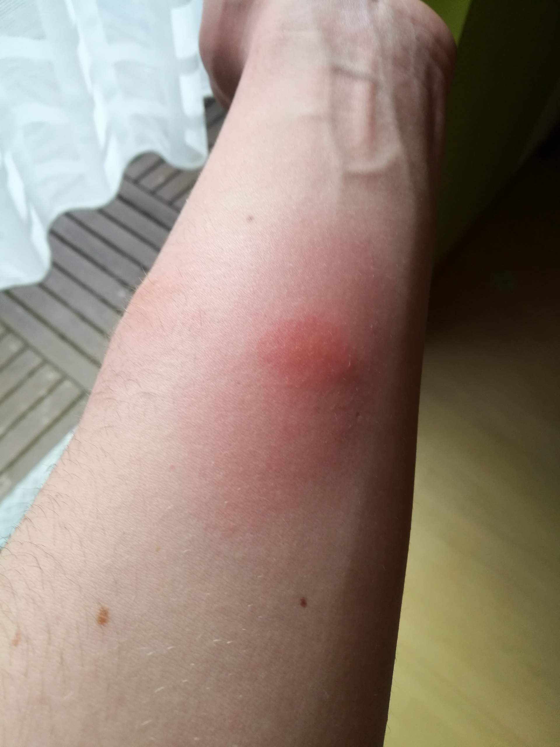 Was ist das für ein Stich/Biss? Eventuell Bettwanze? (Insekten, Bisse)