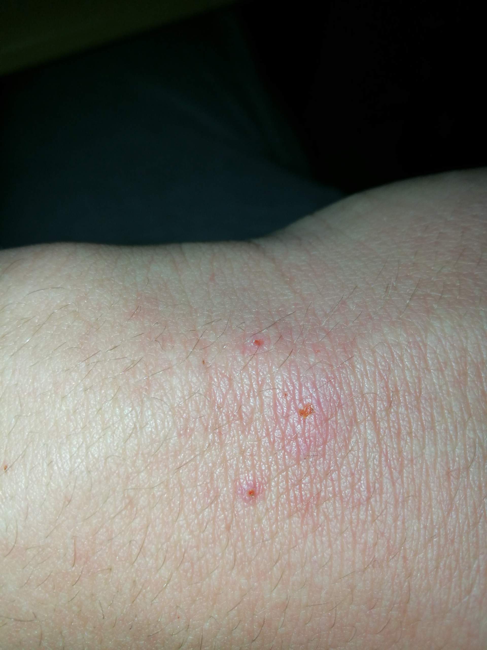 Was ist das für ein Stich/Biss? Eventuell Bettwanze? (Insekten, Bisse)