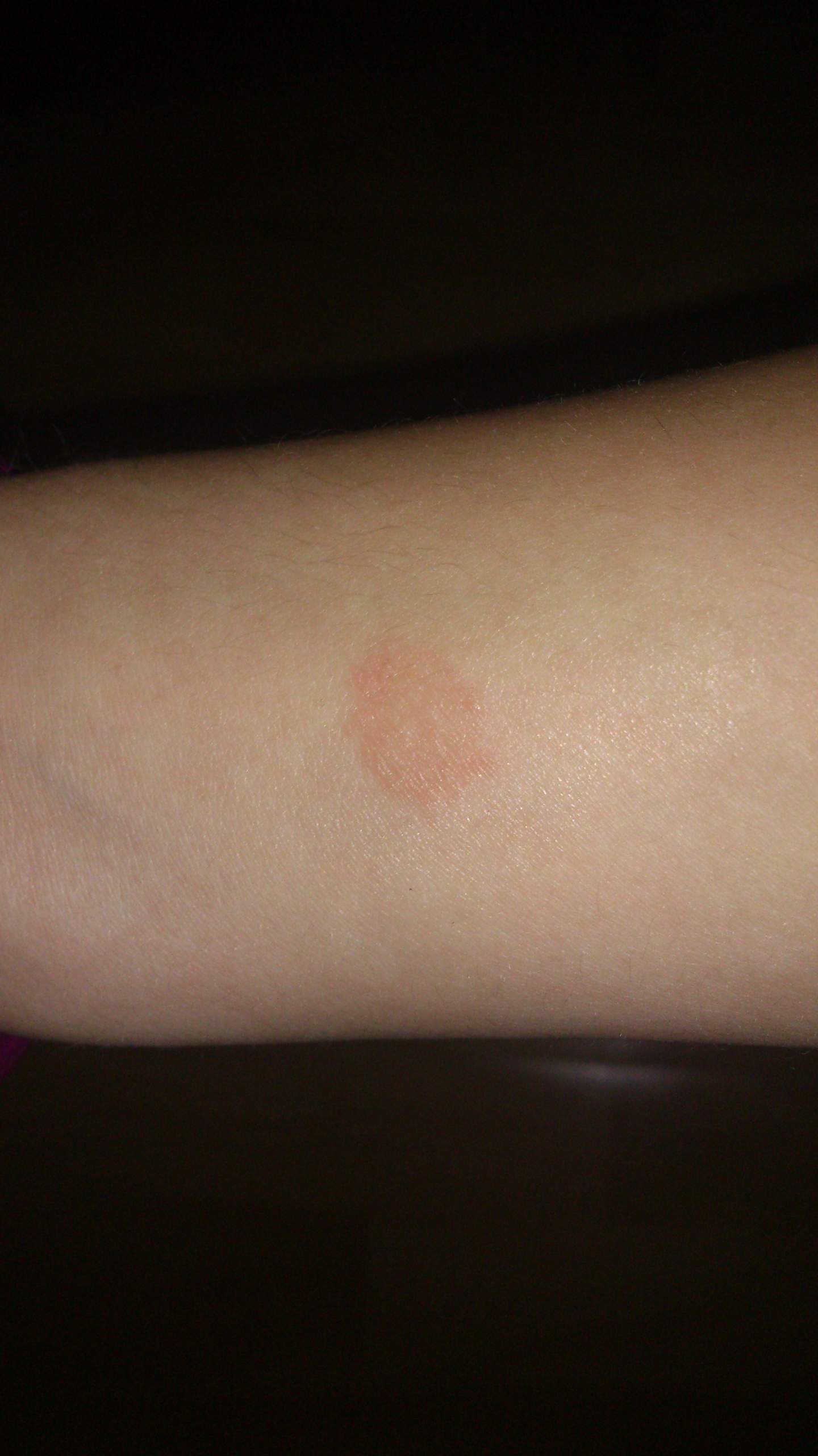 was ist das für eine entzündung / Krankheit? roter fleck am arm? (Haut ...