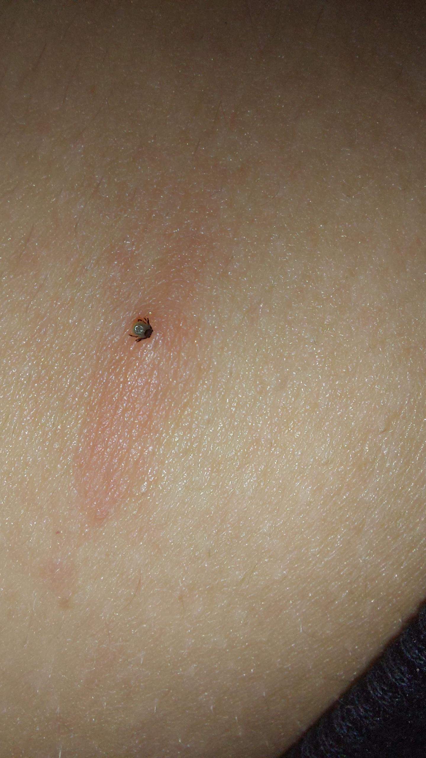 Was ist das für eine zecke? (Medizin, Krankheit, Zecken)