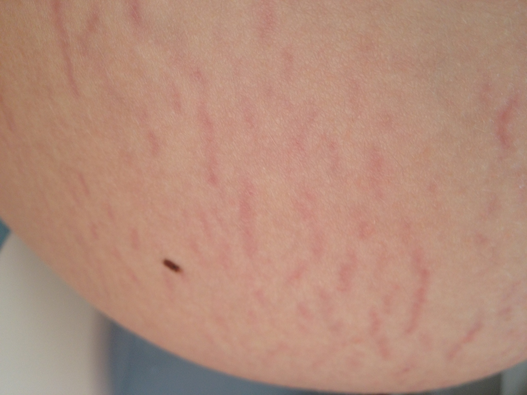 Was ist das? Gerissene haut? (Körper, risse)