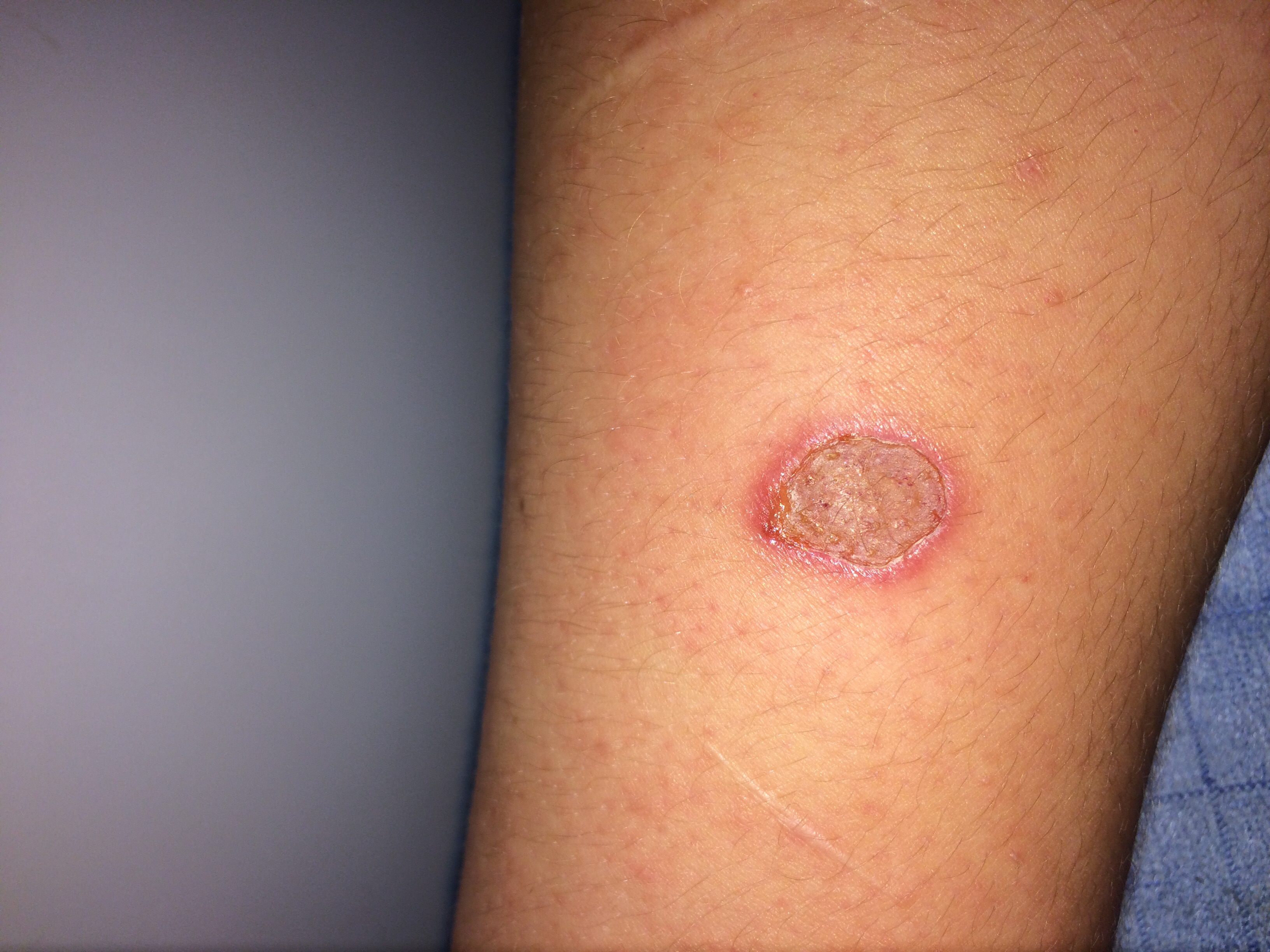 Was ist mit dieser brandwunde los? (Gesundheit und Medizin, Gesundheit ...