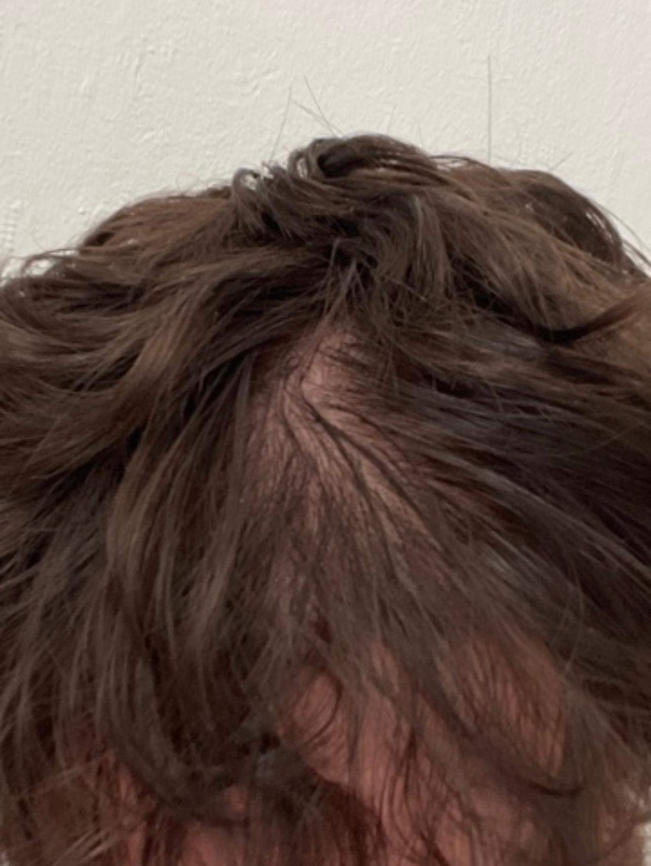 was kann ich gegen genetische haarausfall tun? (Gesundheit und Medizin ...