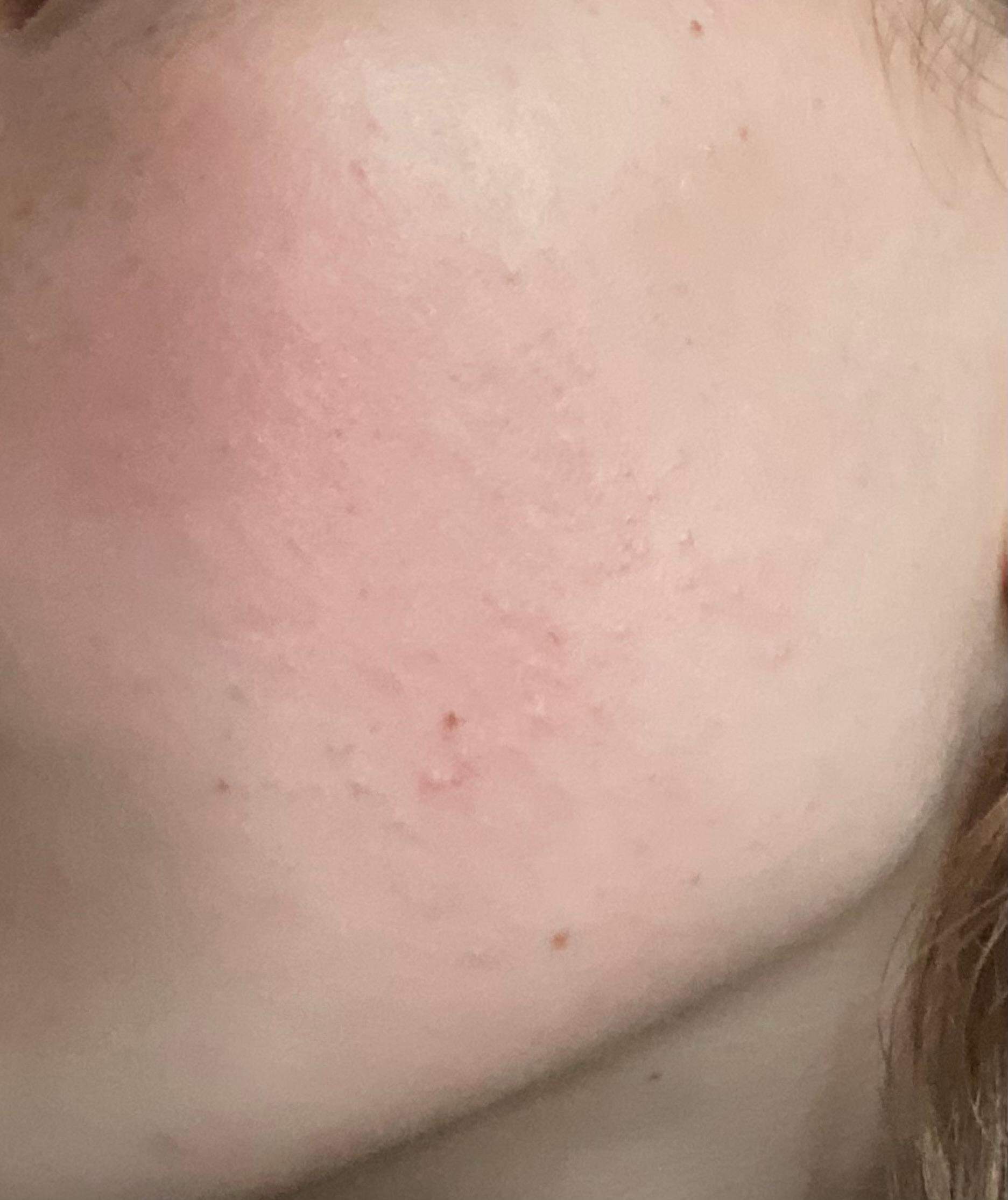 Was sind das für Mini Pickel? (Haut, Gesicht, Hautpflege)