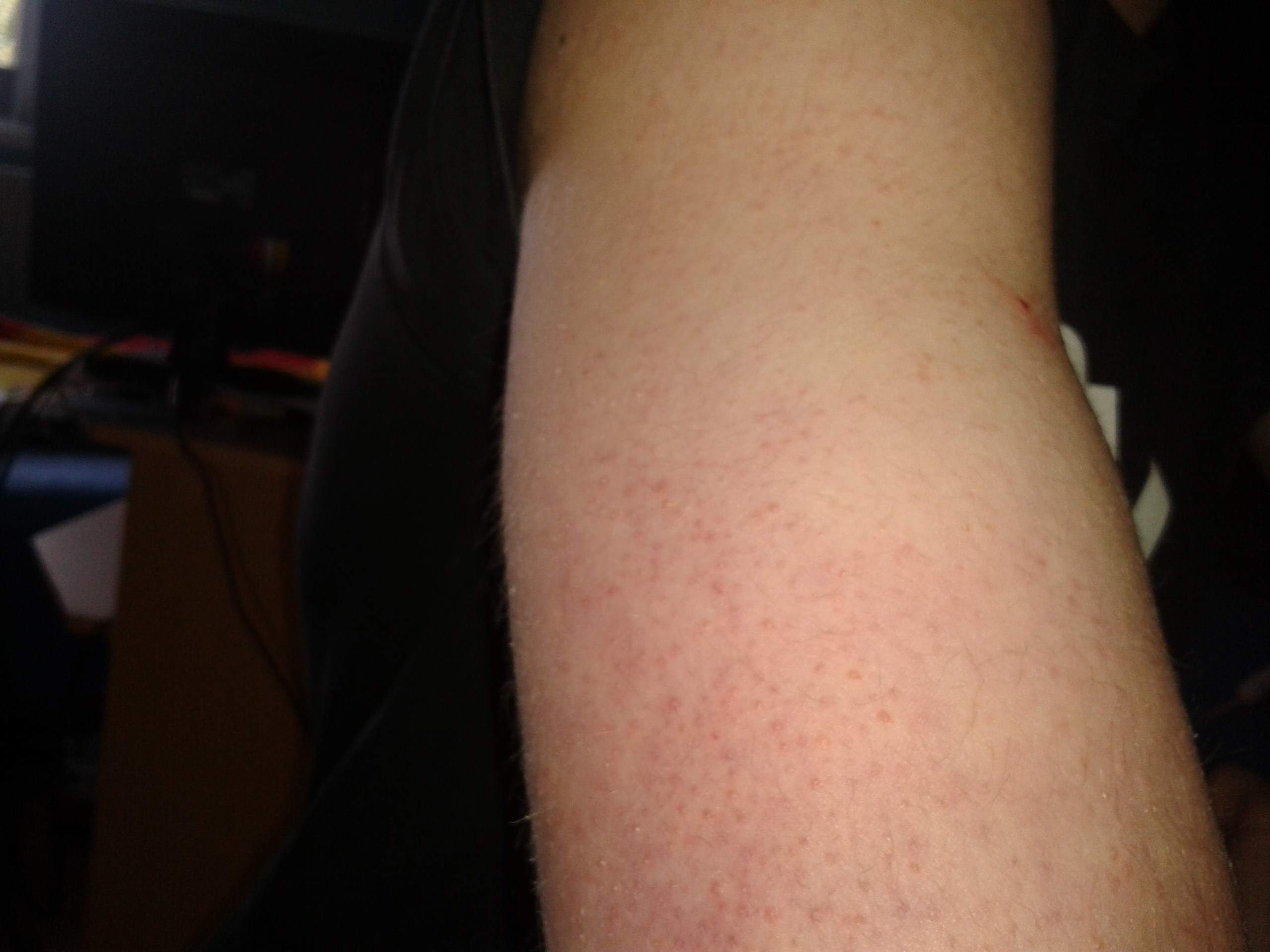 Was sind das für Pickel an meinem Arm?