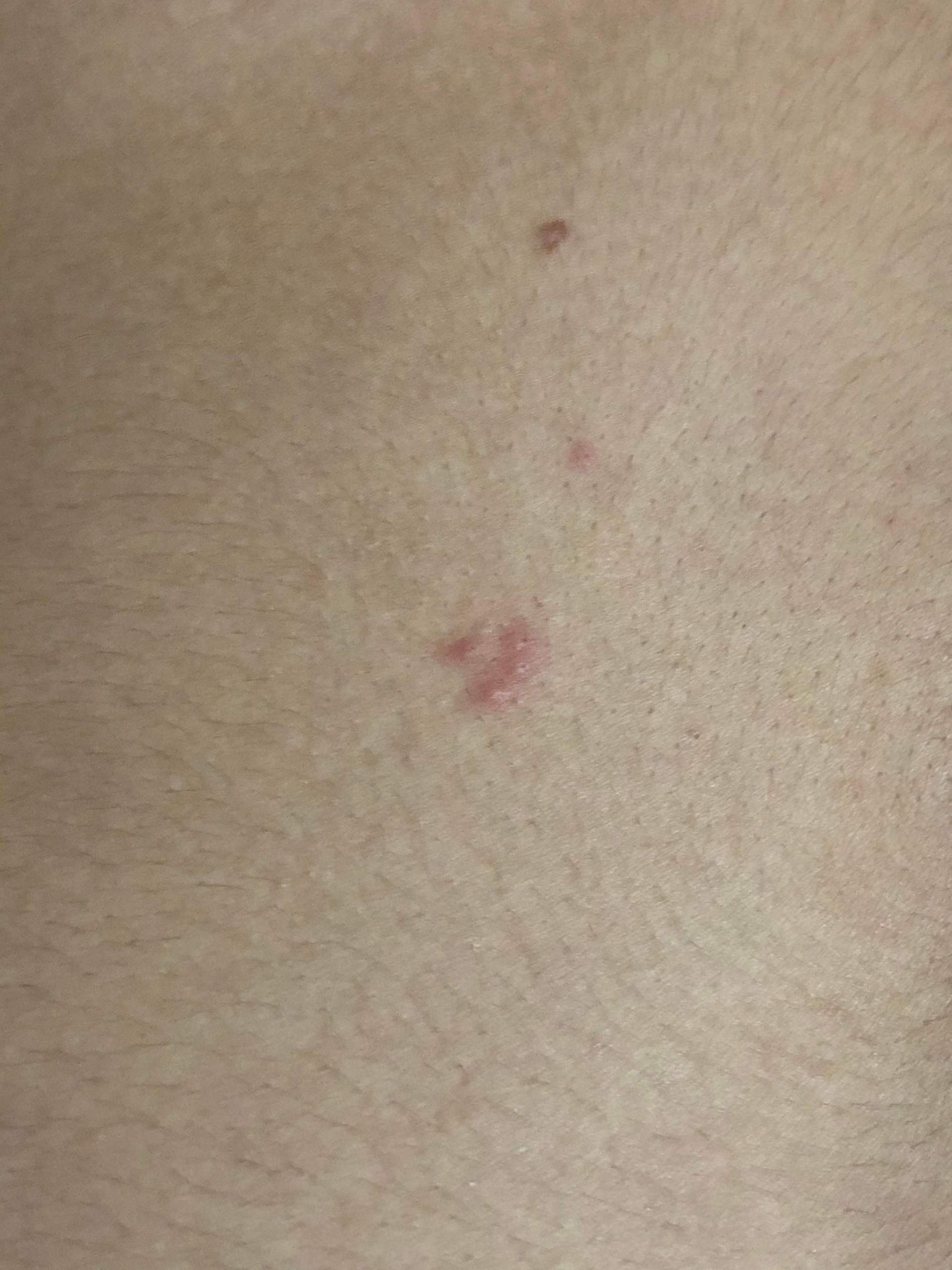 Was sind das für Pickel auf meinem Rücken? (Gesundheit und Medizin ... Was sind das für Pickel auf meinem Rücken? (Gesundheit und Medizin ...