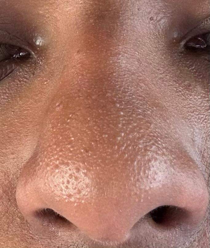 Was sind das für Pickeln auf meiner Nase und wie bekomme ich Sie weg ...