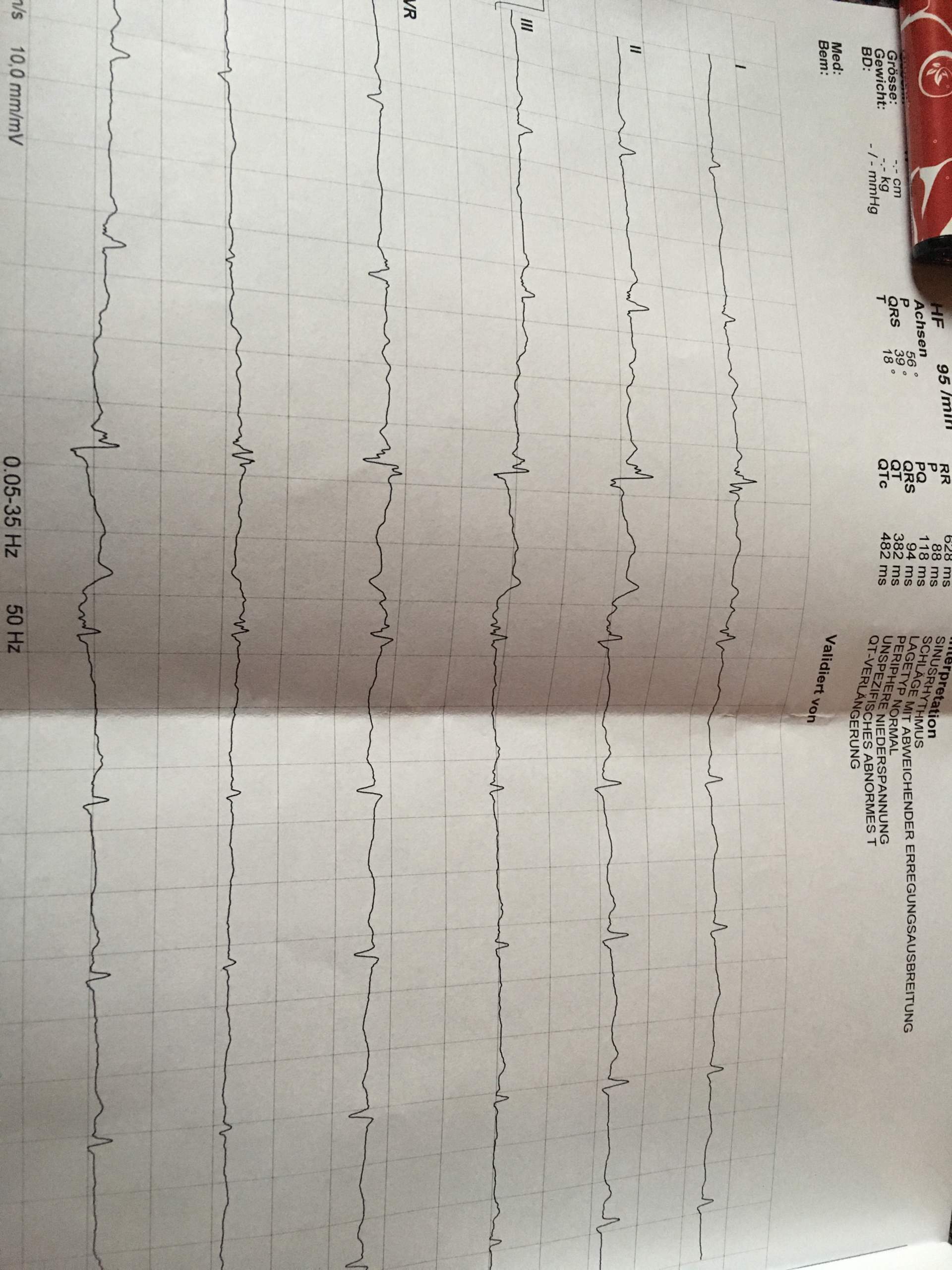 Was sind das für Zacken im ekg? (Gesundheit, Arzt, Krankheit)